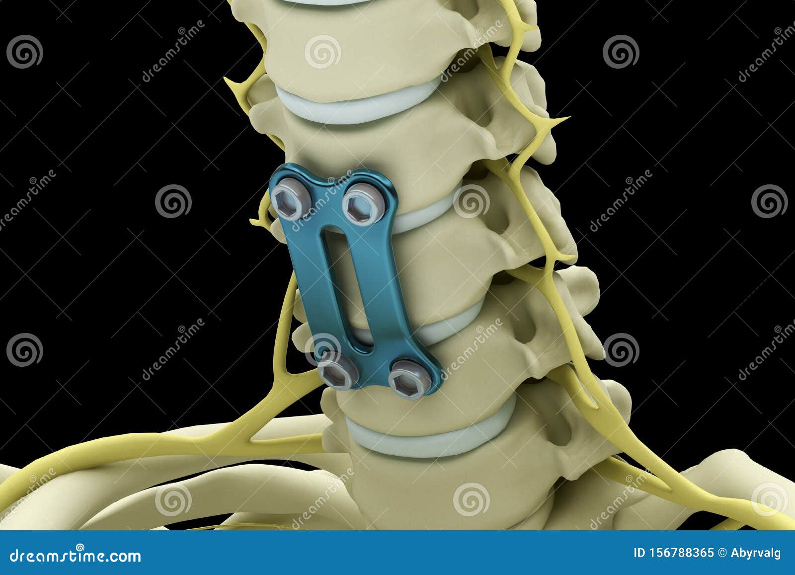 Cervical Vertebrae Fixed with a Metal Plate and Screws. 3d Render Image ...