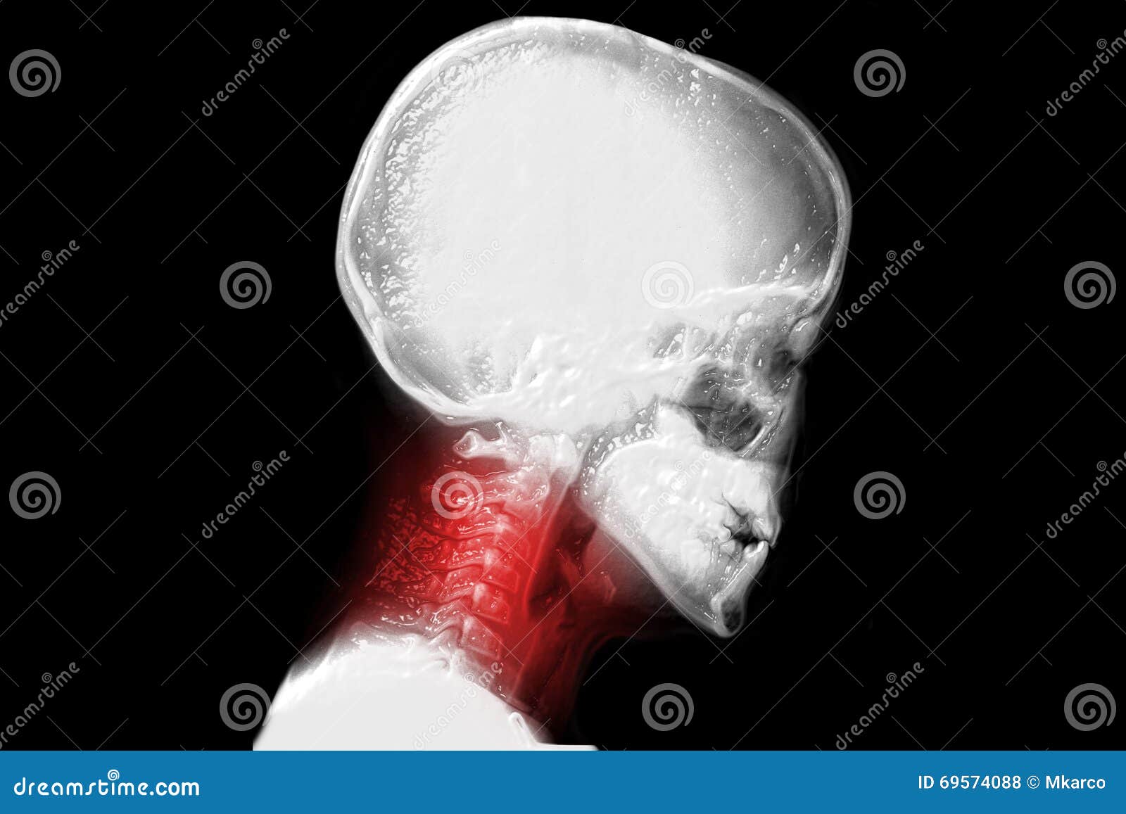 Cervical Vertebrae, Neck Pain Stock Photo - Image of tension, sore ...