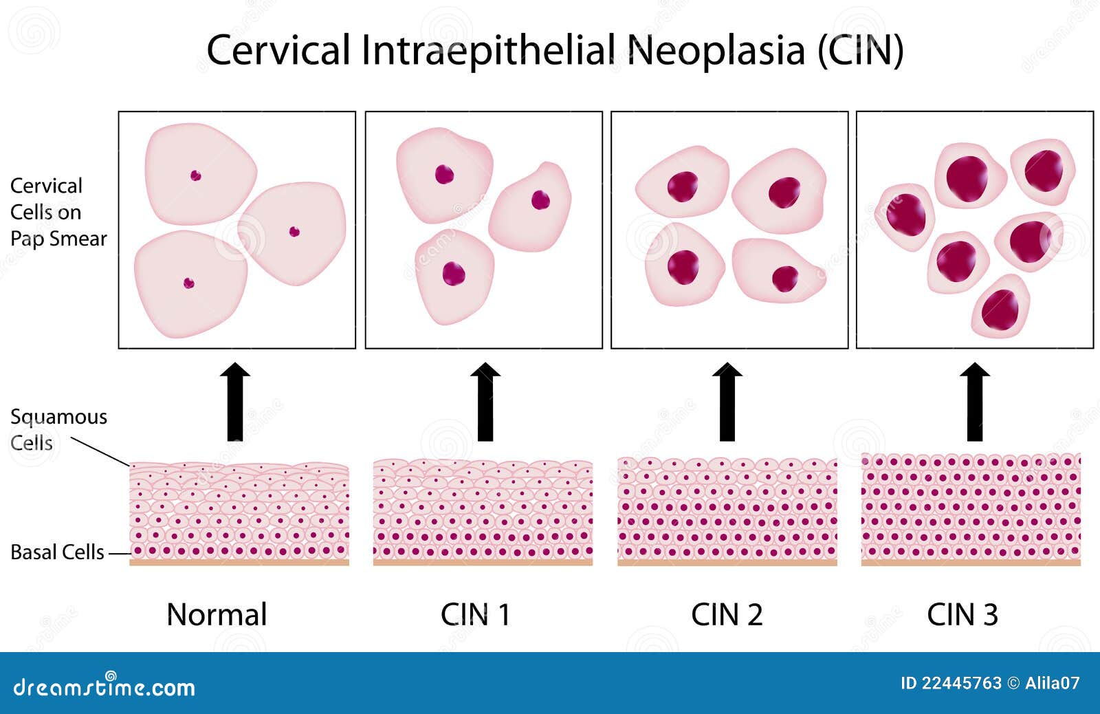 Cervicale dysplasie vector illustratie. Illustration of gezondheid ...