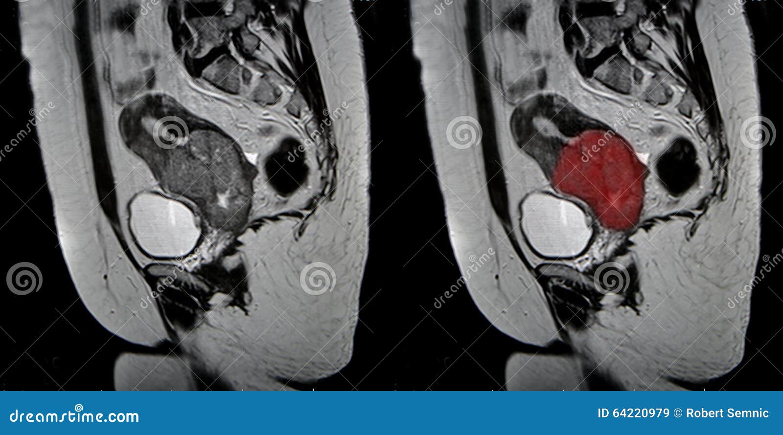 Cervicale kanker, MRI stock afbeelding. Image of procedure - 64220979