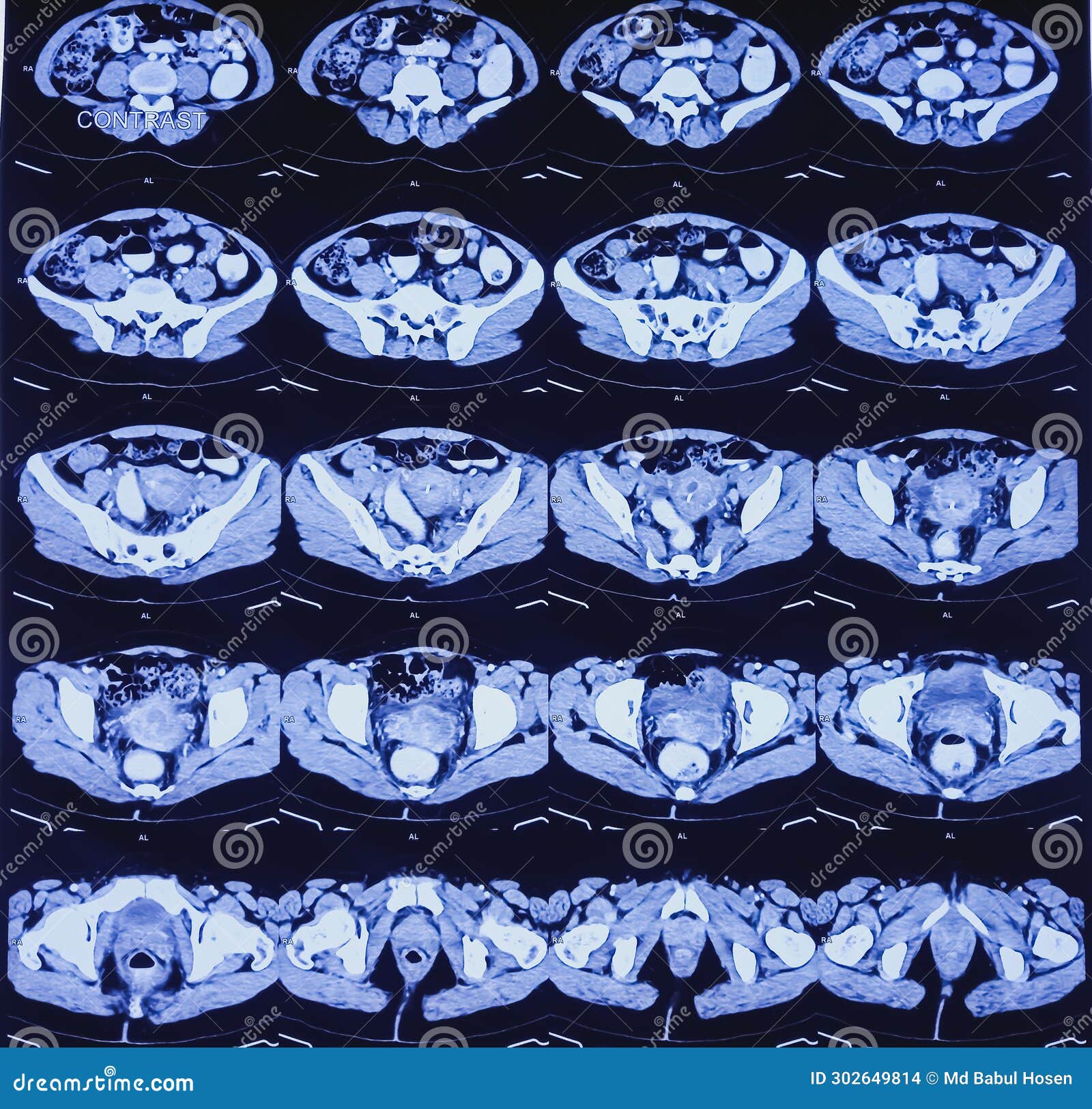 Cervix Carcinoma. CT Scan of Cervix of Uterus Editorial Stock Image - Image of cervix, anatomy ...