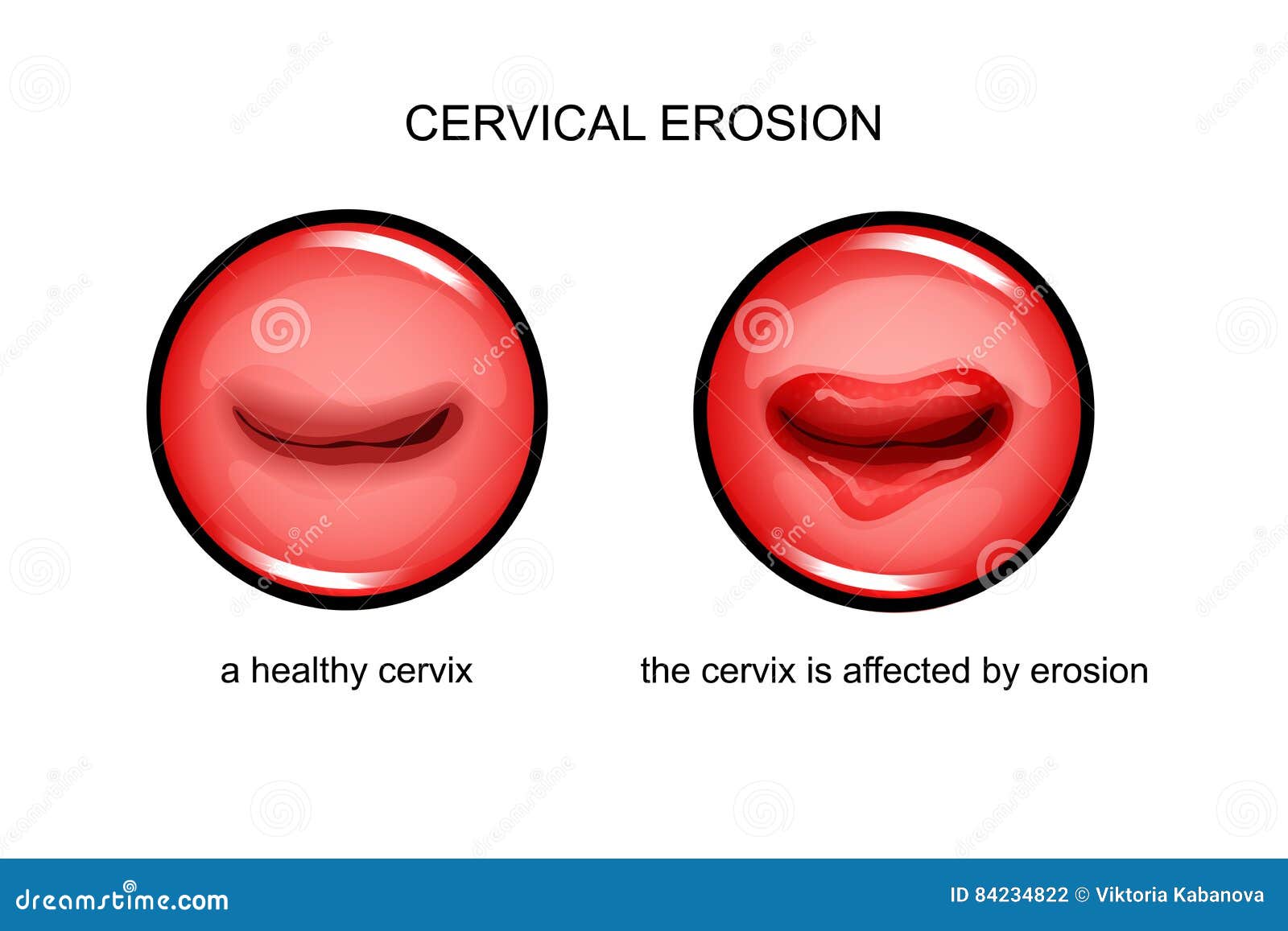 A Cerviz é Afetada Pela Erosão Ilustração do Vetor - Ilustração de ...