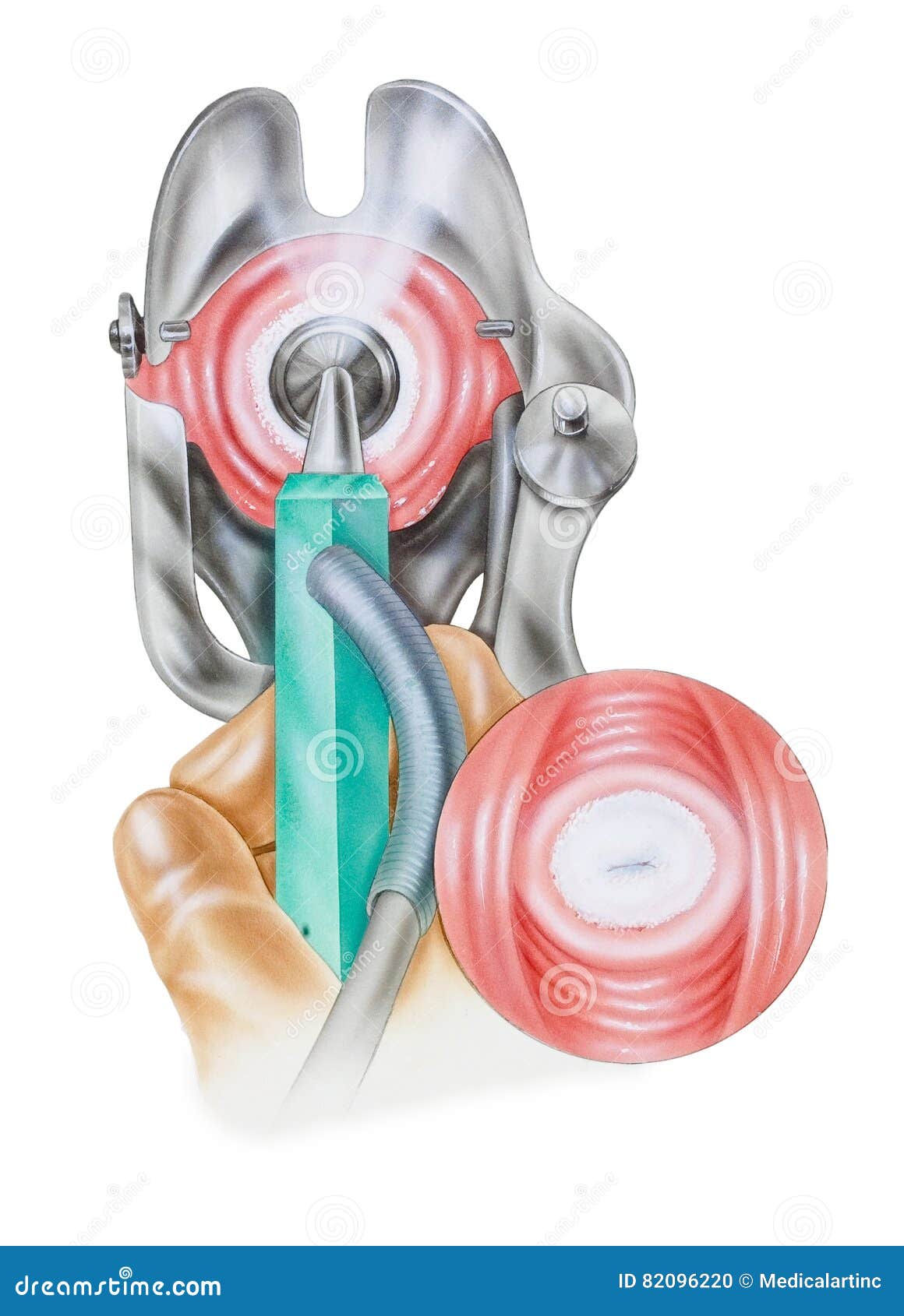 Cerviz - Cryosurgery De Lesões Cervicais Ilustração Stock - Ilustração ...