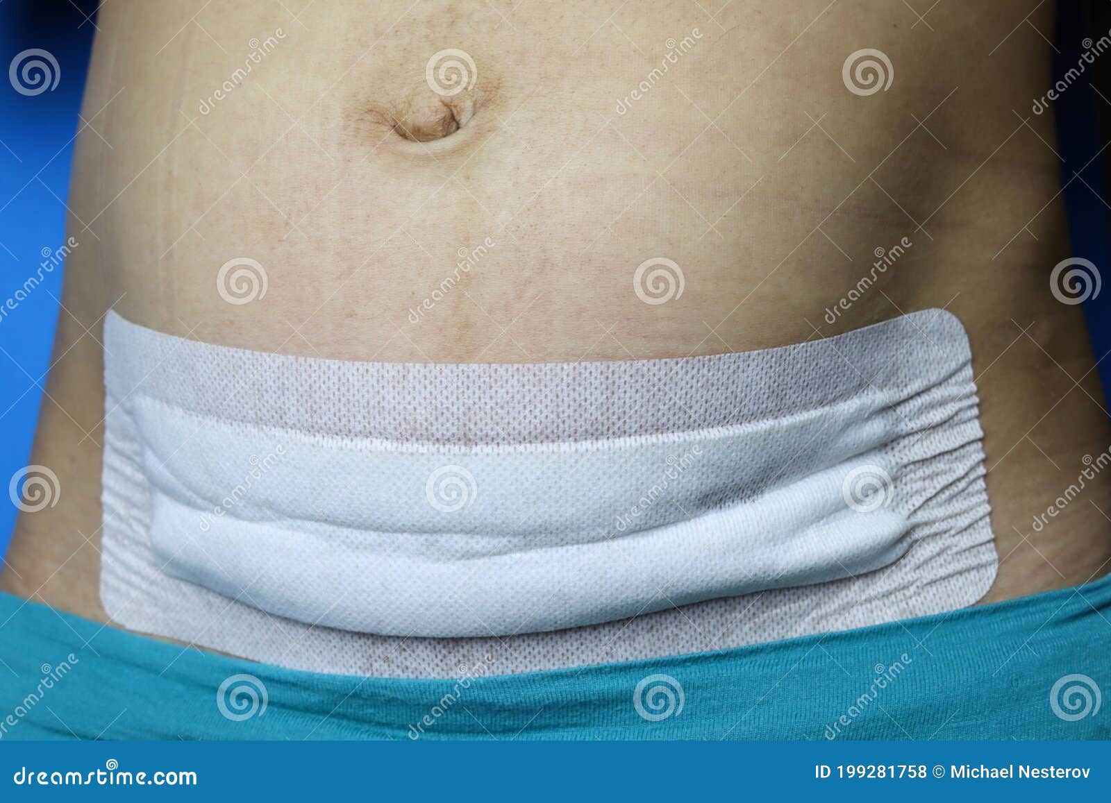 Cesarean Section Bandage. Postpartum Rehabilitation Stock Photo - Image ...