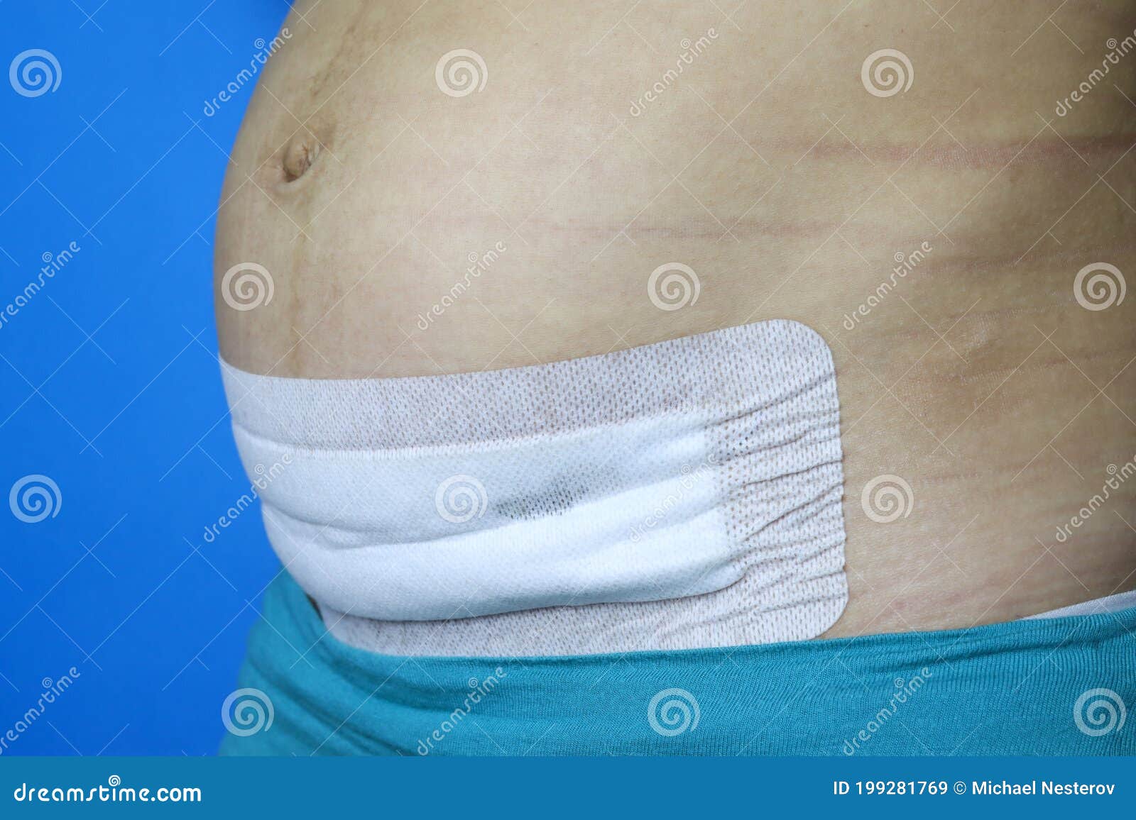 Cesarean Section Bandage. Postpartum Rehabilitation Stock Image - Image ...