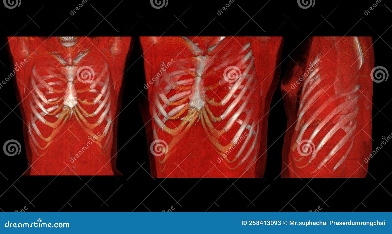 Ch Brustkorb 3d Das Eine Realistische Brustkorbbildung Anatomisch Korrekt Macht Stock Abbildung