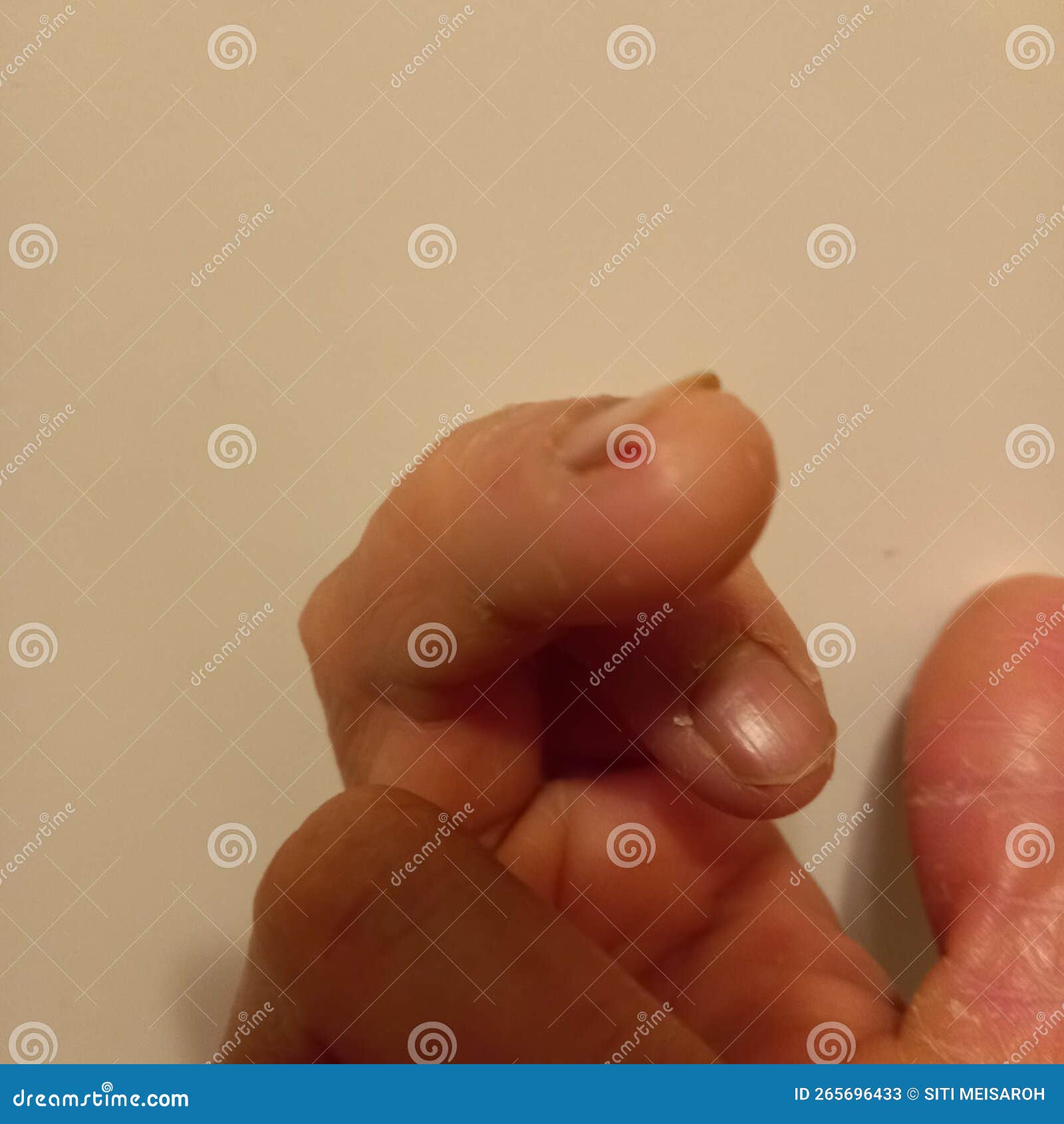 Chaffed finger skin stock image. Image of head, face - 265696433