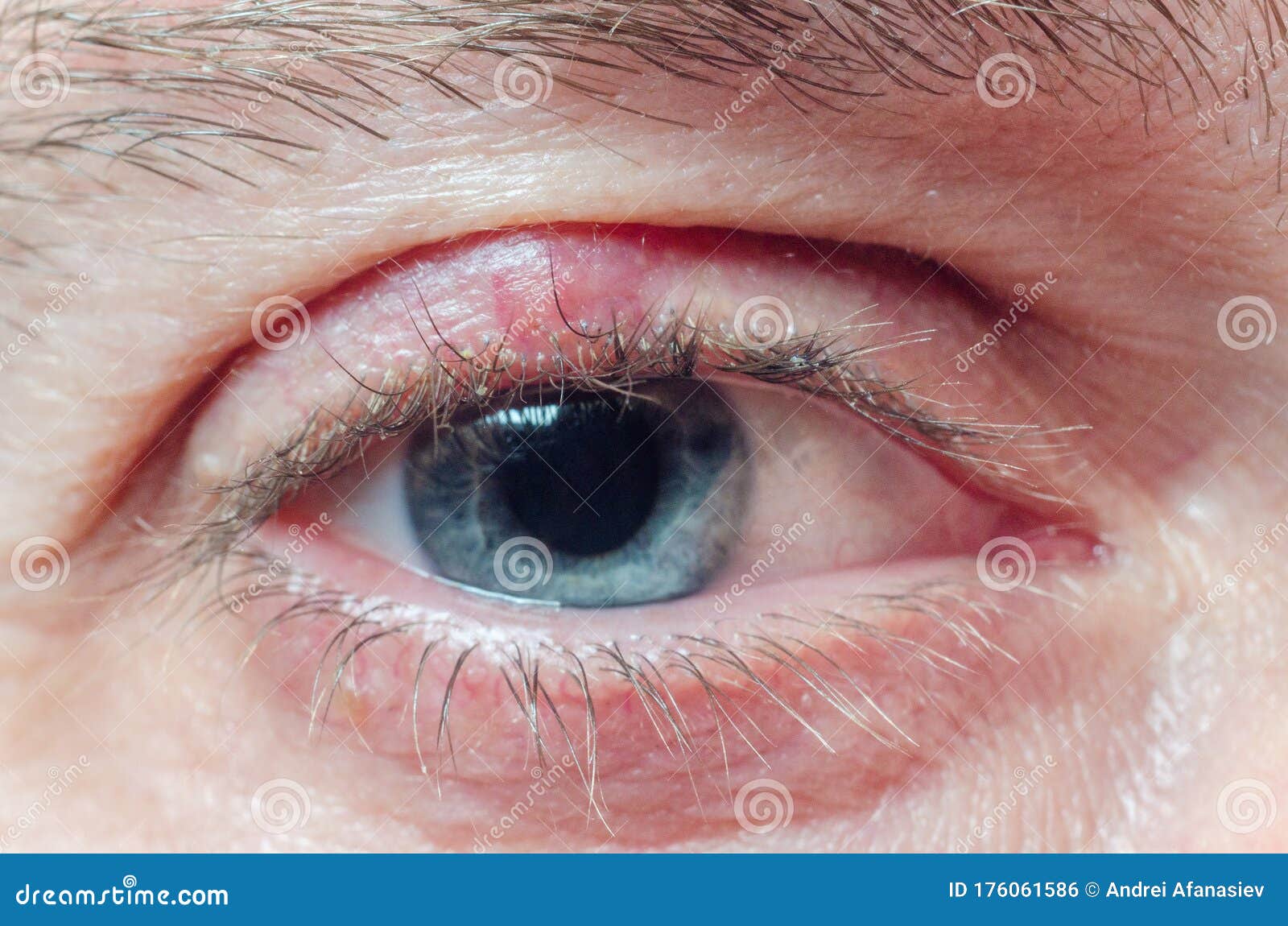 Chalazion on the Eyelid of a Man Close-up Stock Photo - Image of ...