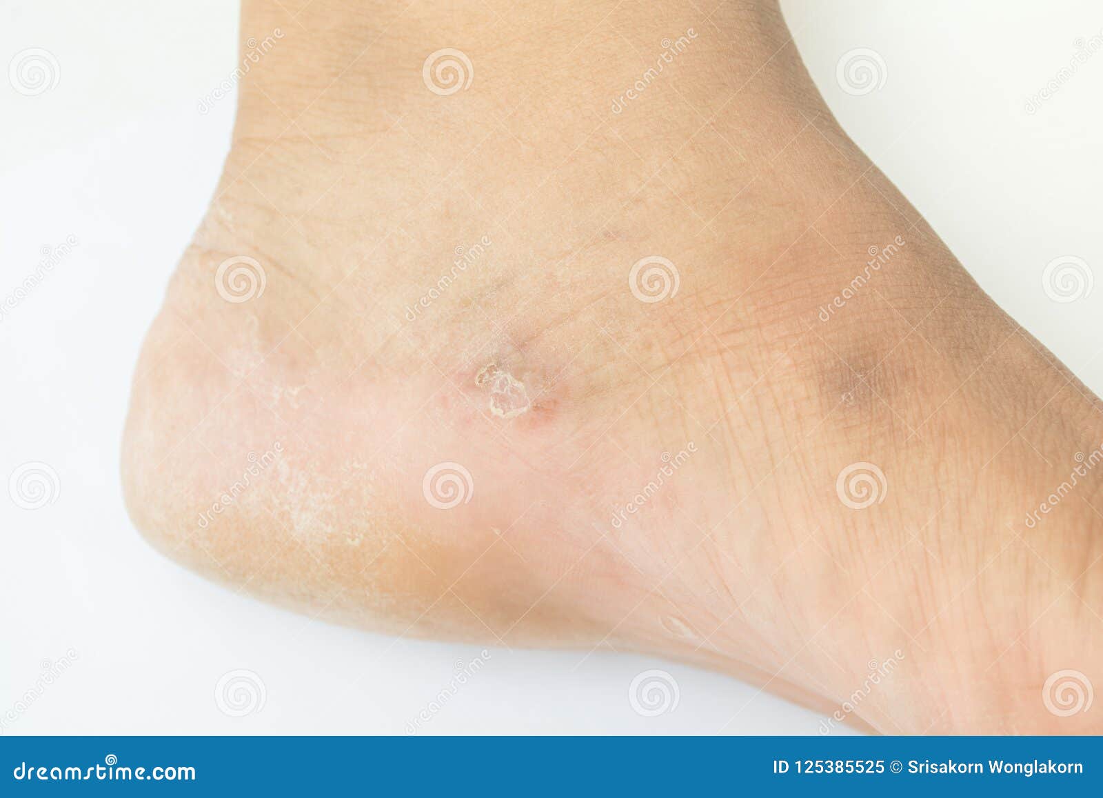 Champignon Et Maladie De Pied Image stock - Image of problèmes, mycète ...