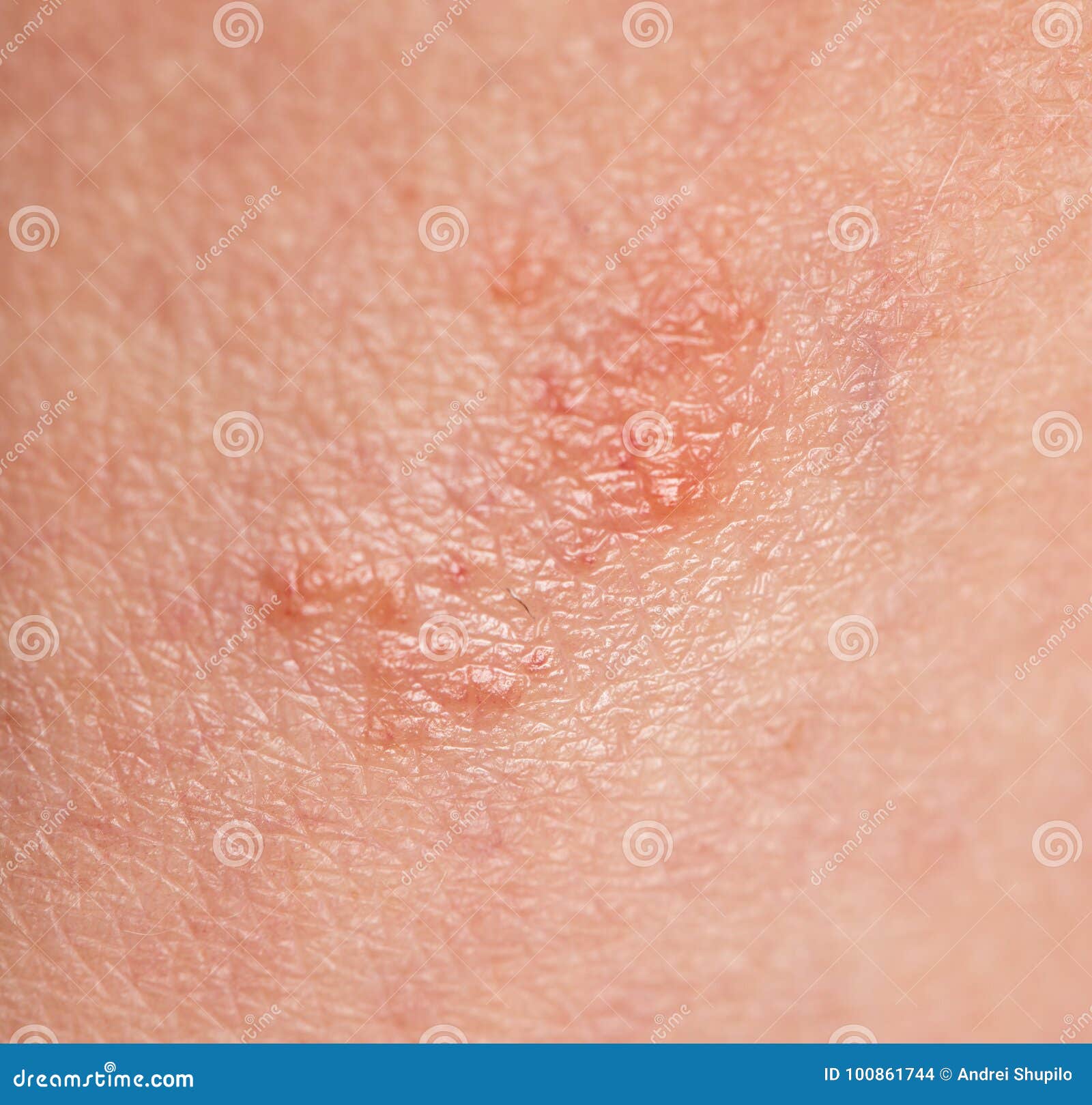 Champignon Sur La Peau Humaine Macro Photo stock - Image du mycète ...