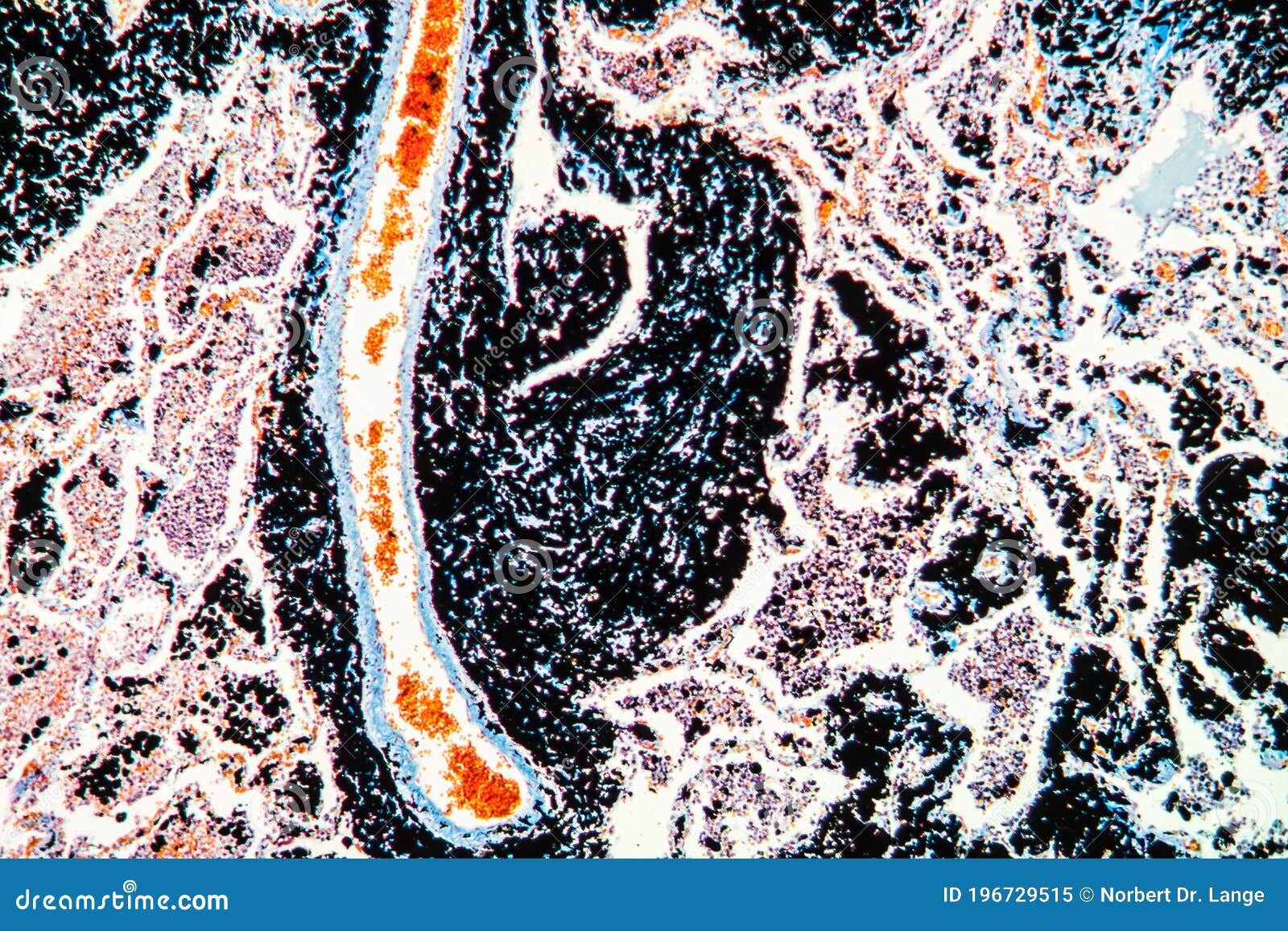 Charcoal Dust Lung Tissue Under the Microscope Stock Image - Image of ...