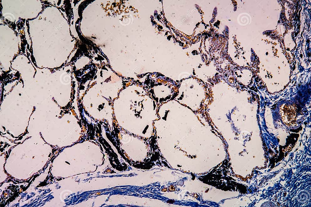 Charcoal dust lung tissue stock photo. Image of glass - 196729538