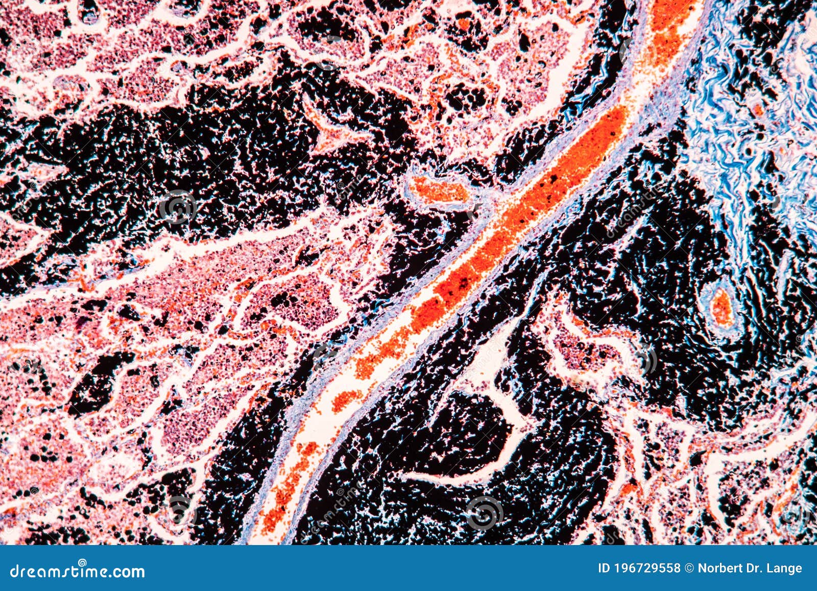 Charcoal dust lung tissue stock photo. Image of microscopy - 196729558