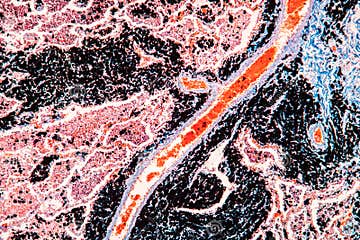 Charcoal dust lung tissue stock photo. Image of microscopy - 196729558