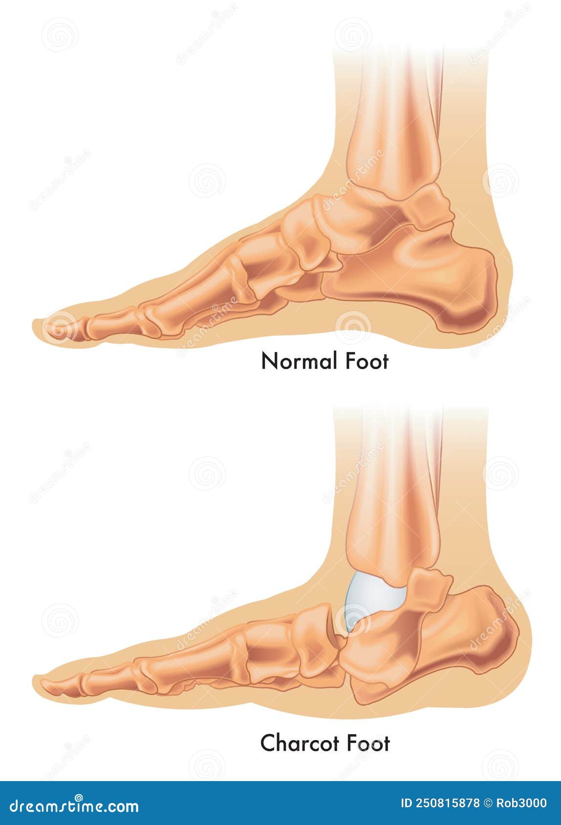 Charcot foot stock vector. Illustration of bone, feet - 250815878