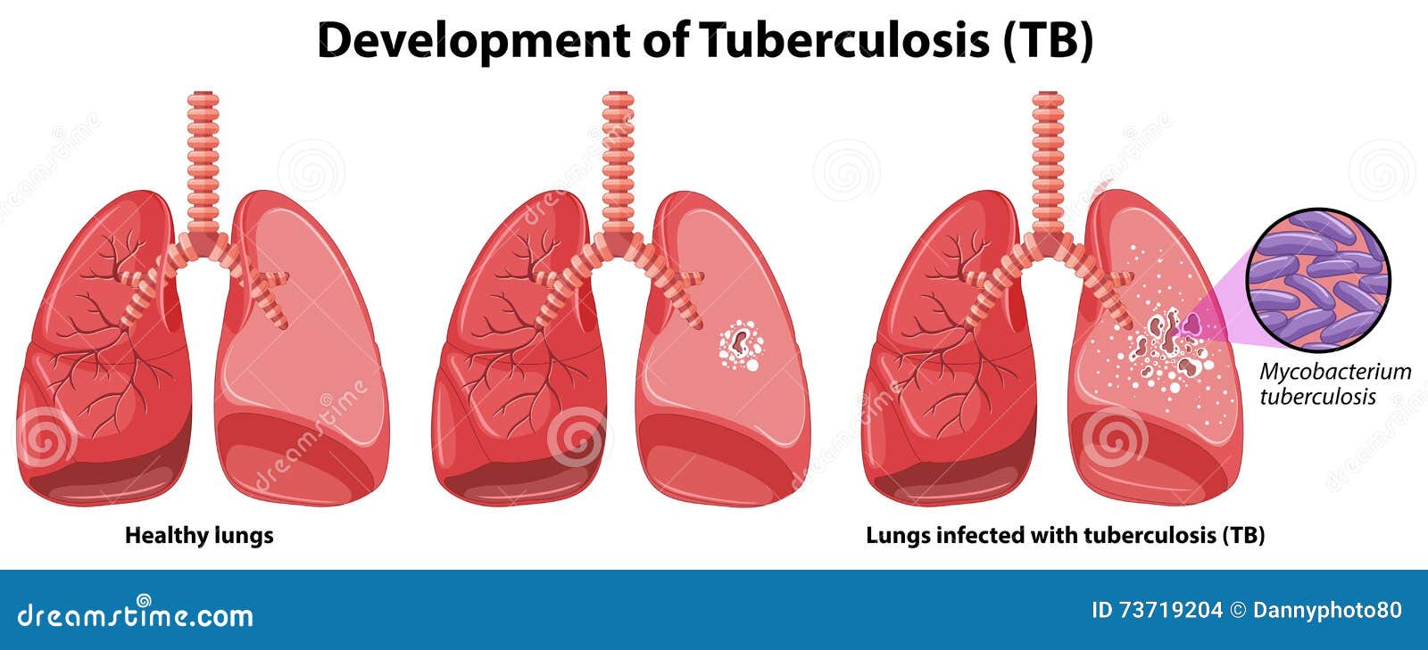 Chart Showing Development of Tuberculosis Stock Vector - Illustration ...