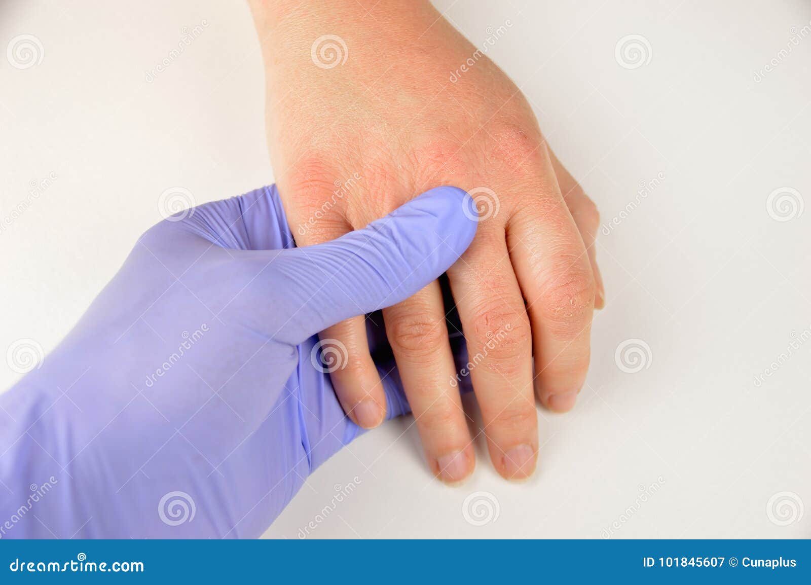 Checking the hand stock image. Image of care, allergy - 101845607