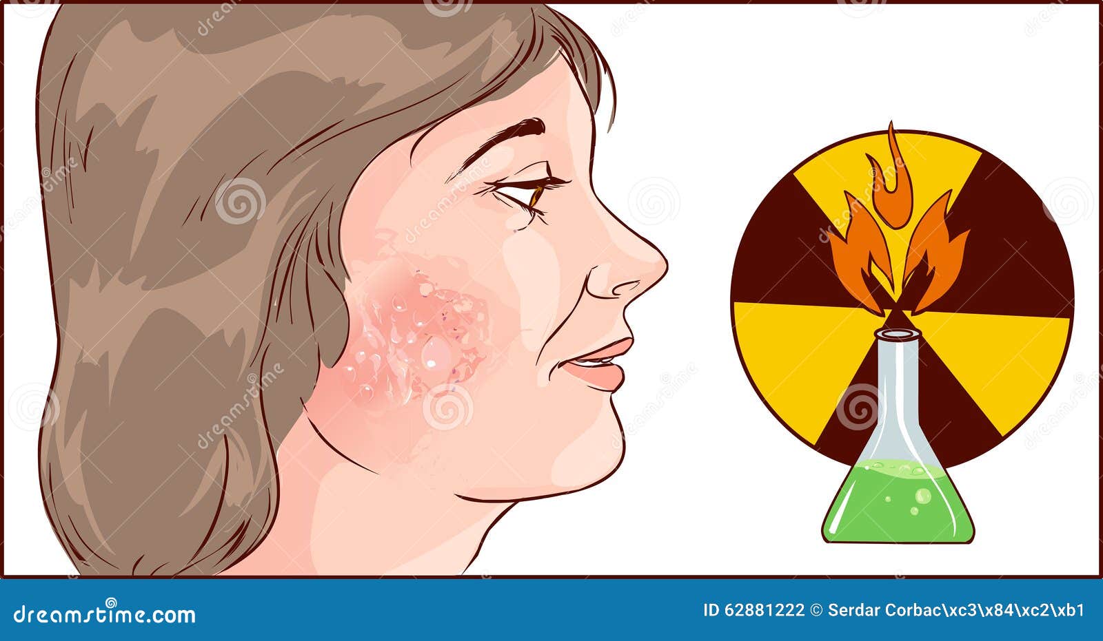 Chemical burns to face stock vector. Illustration of hospital - 62881222