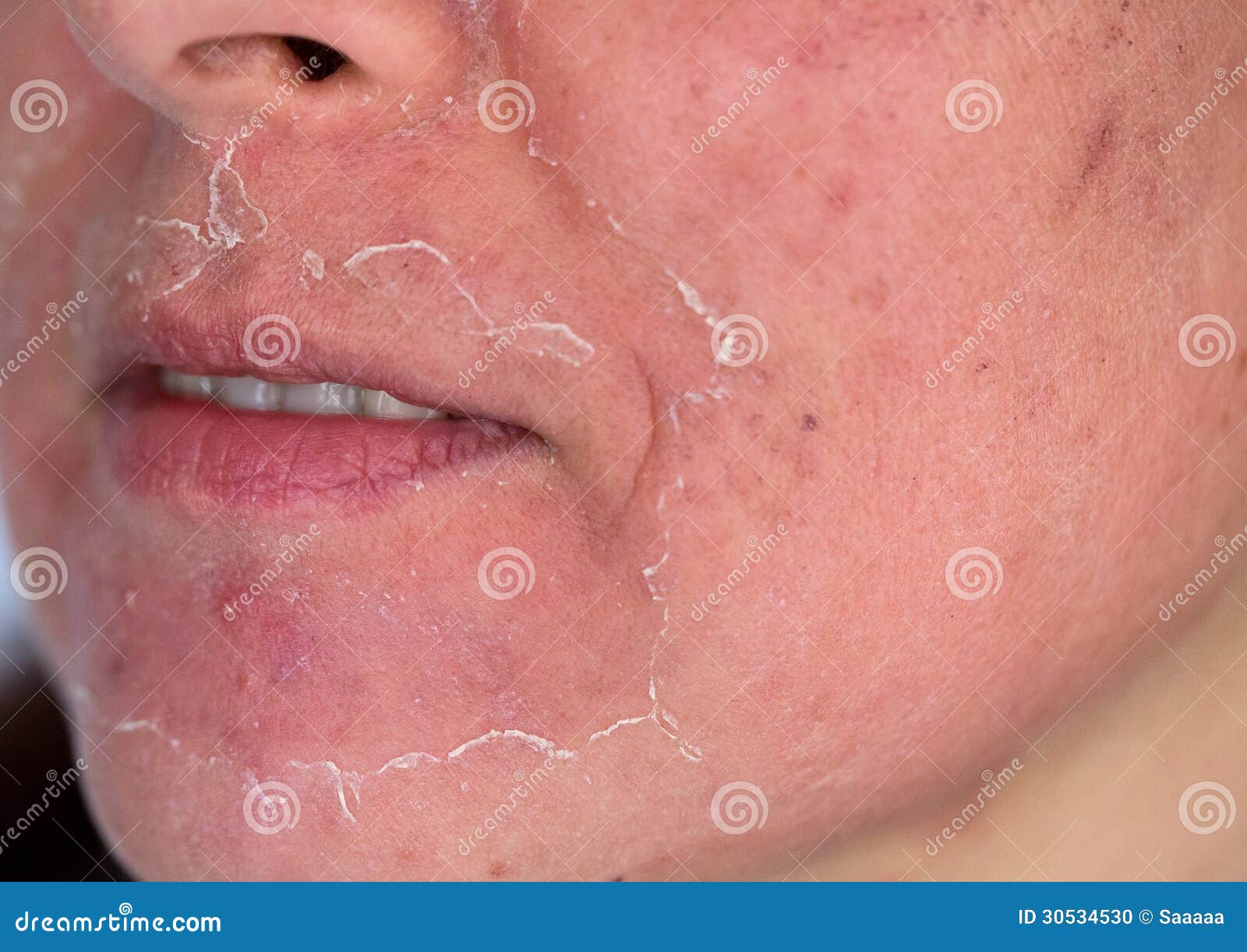 Chemische schil stock foto. Image of gepigmenteerd, acne - 30534530