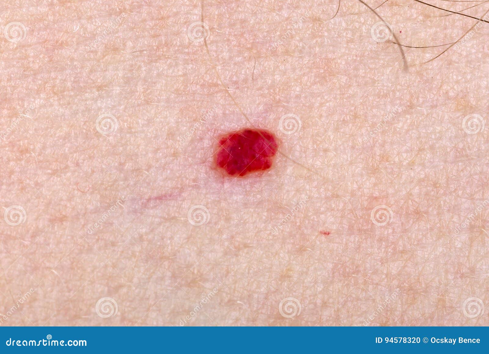 Angioma On The Skin. Red Moles On The Body. Many Birthmarks. Stock ... Angioma On The Skin. Red Moles On The Body. Many Birthmarks. Stock ...