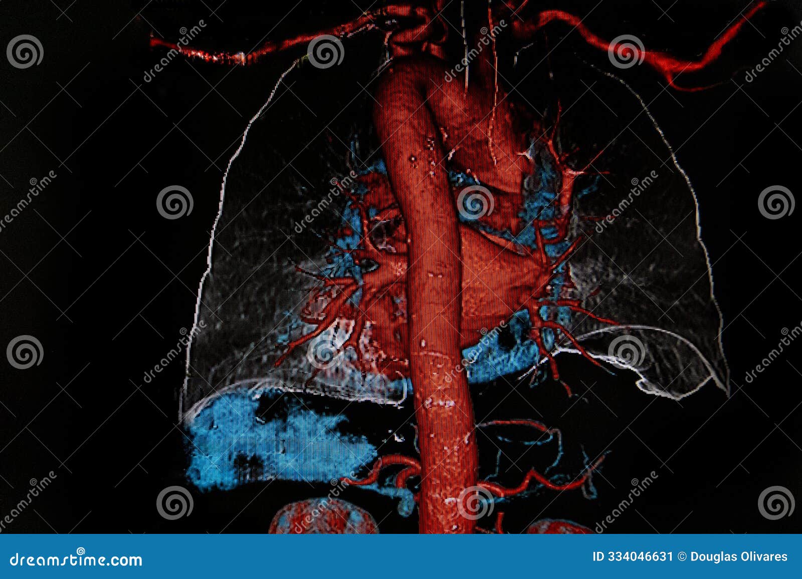 Chest Angiography. 3D Rendering Image Stock Image - Image of scan ...