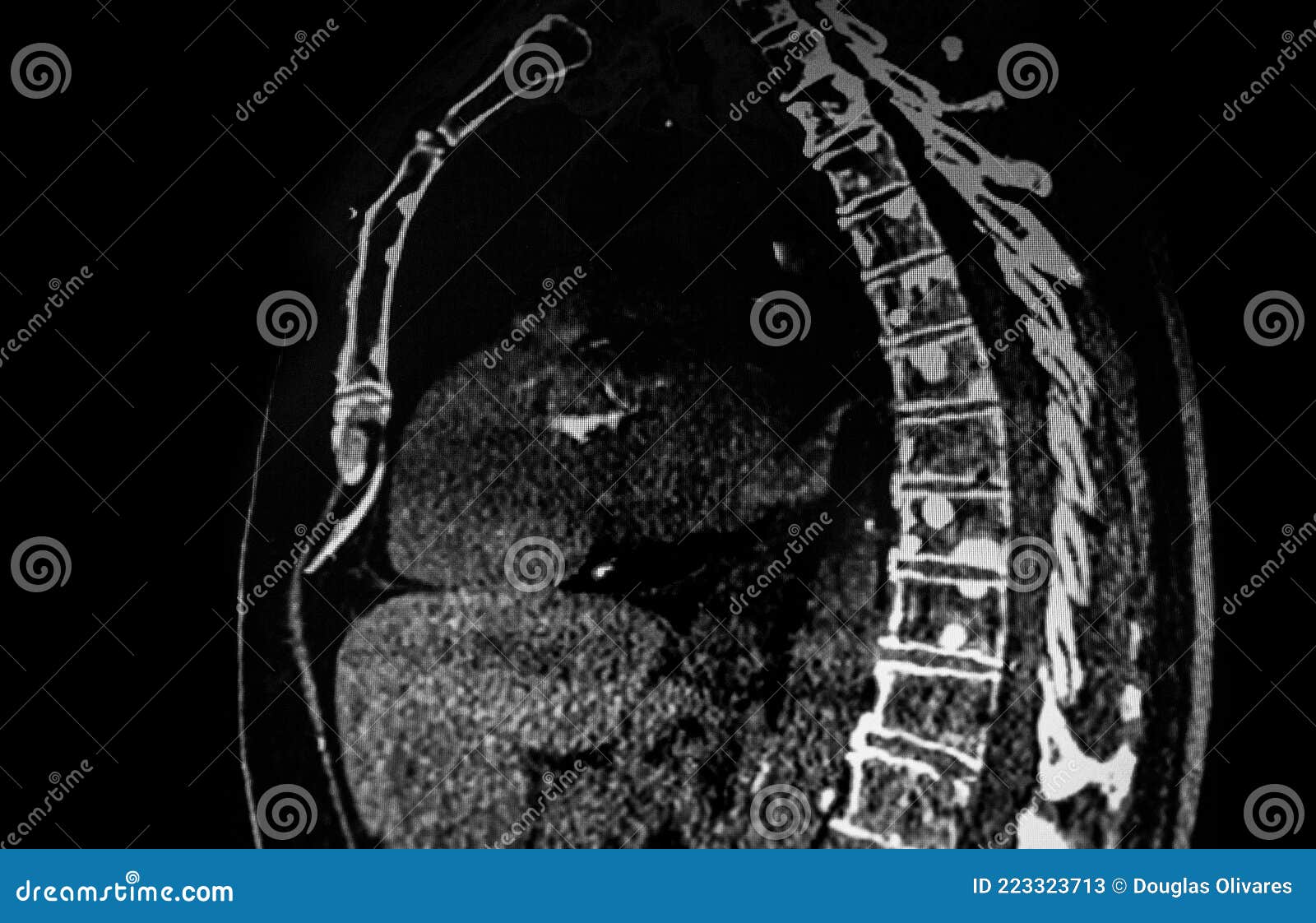 Chest CT Scan Showing Metastatic Tumoral Lesions on the Vertebra Stock ... Chest CT Scan Showing Metastatic Tumoral Lesions on the Vertebra Stock ...