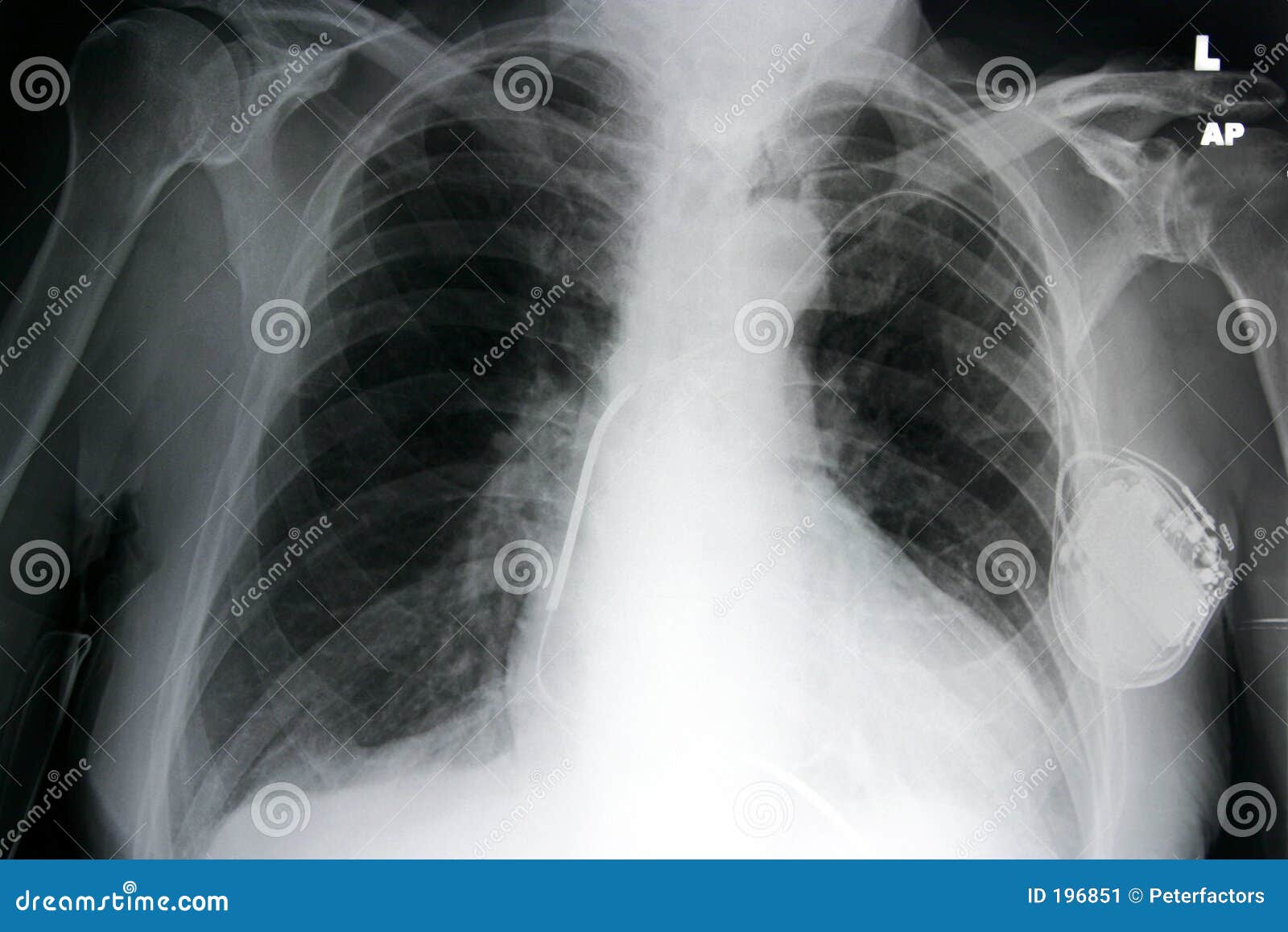 Chest+pacemaker stock image. Image of life, film, injury - 196851