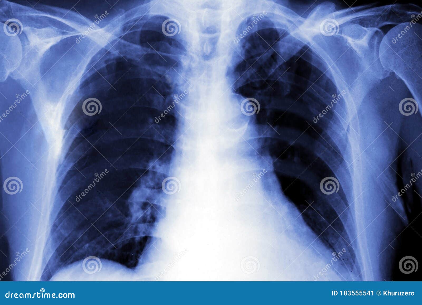 X-ray film stock image. Image of pulmonary, radiation - 183555541