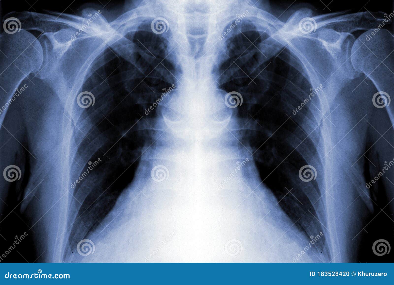 X-ray film stock photo. Image of roentgenogram, department - 183528420