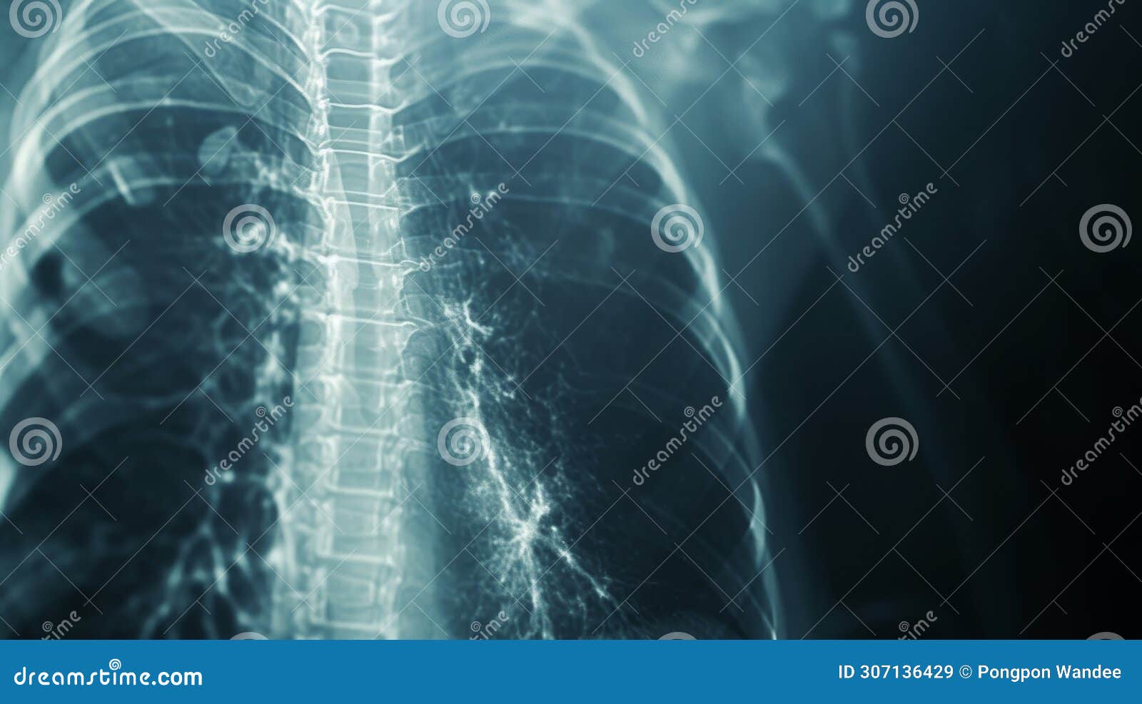 Chest Radiograph X-ray Chested Medicals Health Lung Radiology Bone ...