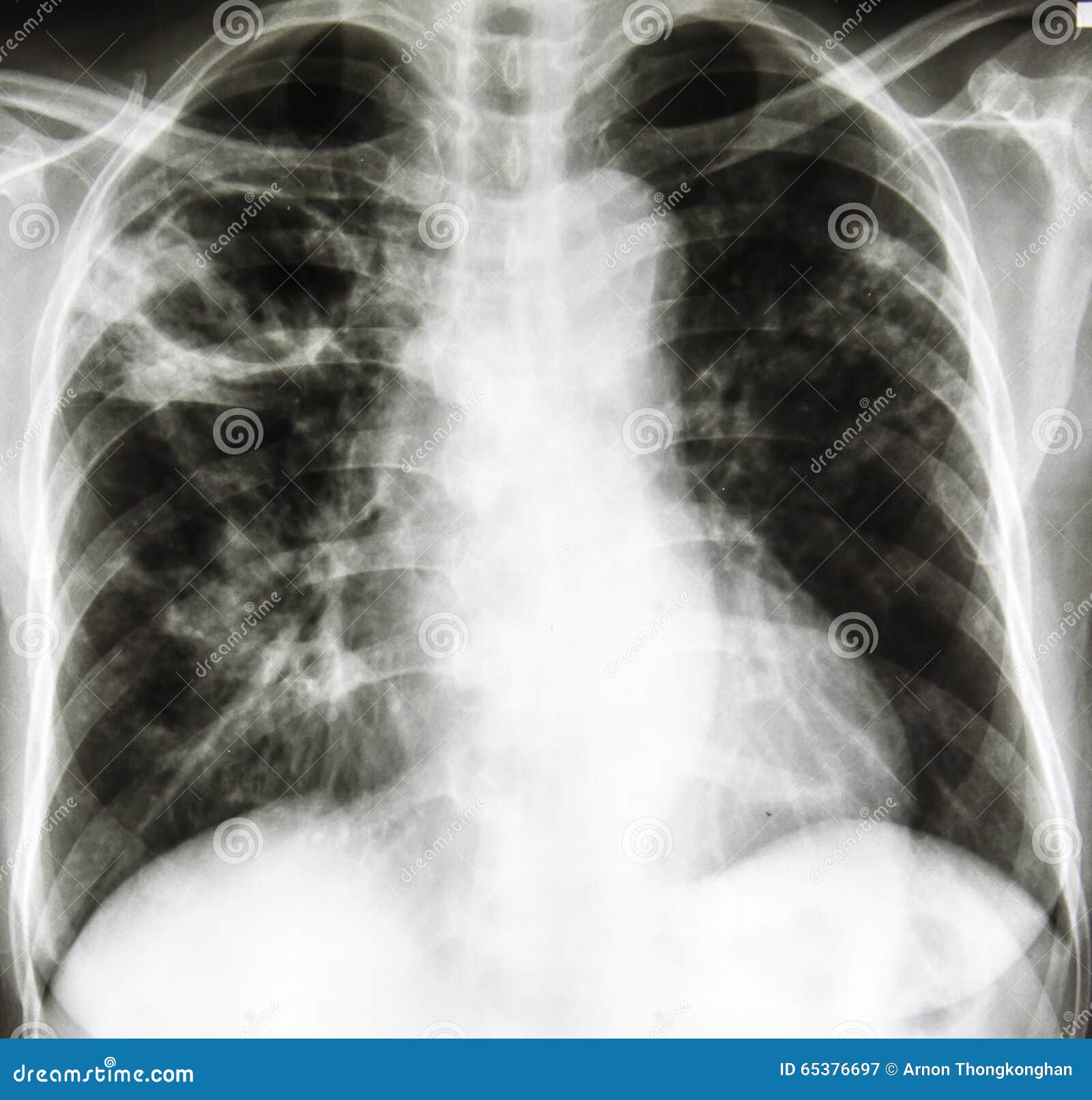 Chest radiography stock image. Image of cavity, tuberculosis - 65376697
