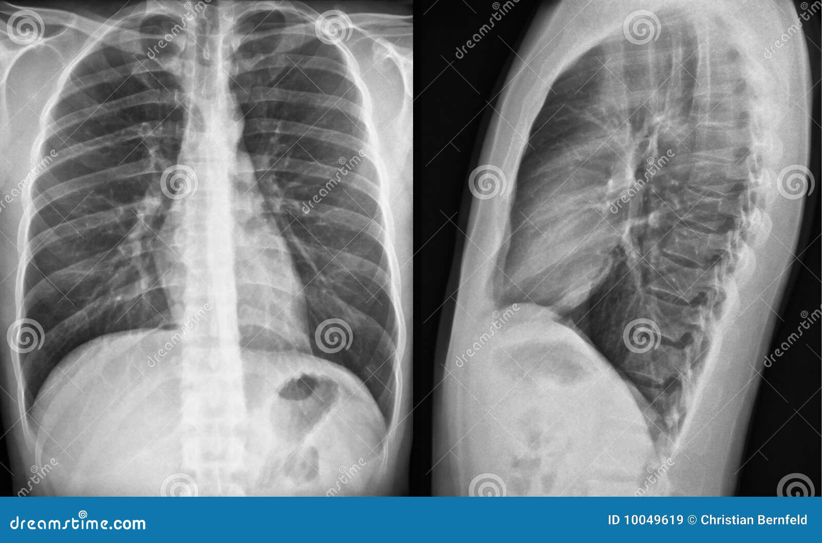 Chest X-Ray stock image. Image of radiation, bones, radiology - 10049619