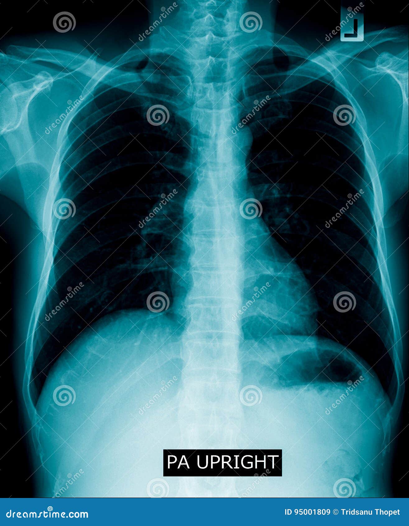 Chest x-ray stock image. Image of health, physical, isolated - 95001809