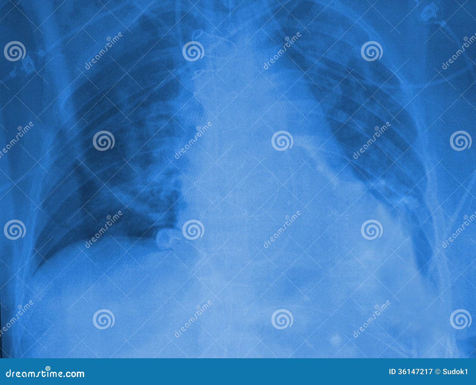 Chest X-ray. Blue toning stock image. Image of healthcare - 36147217