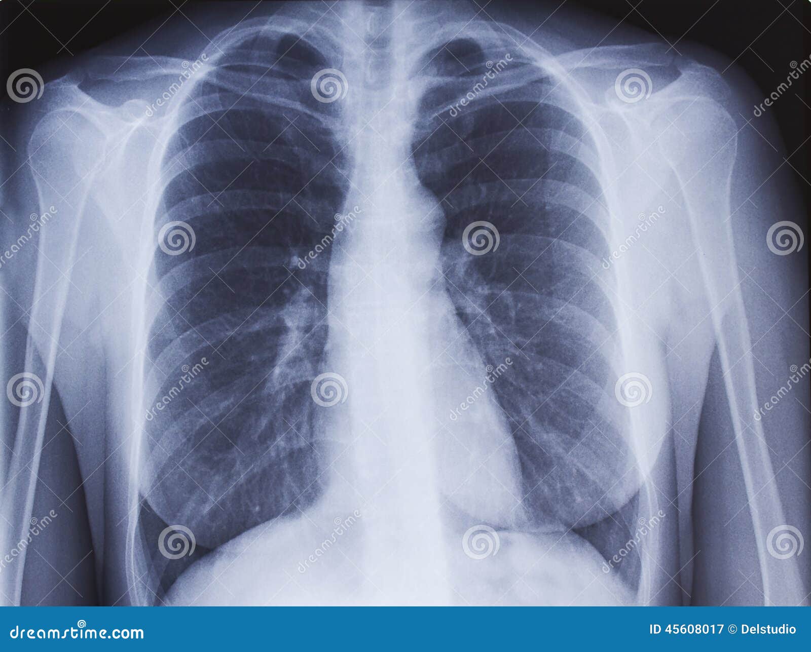 Chest x-ray stock image. Image of thorax, medical, healthy - 45608017