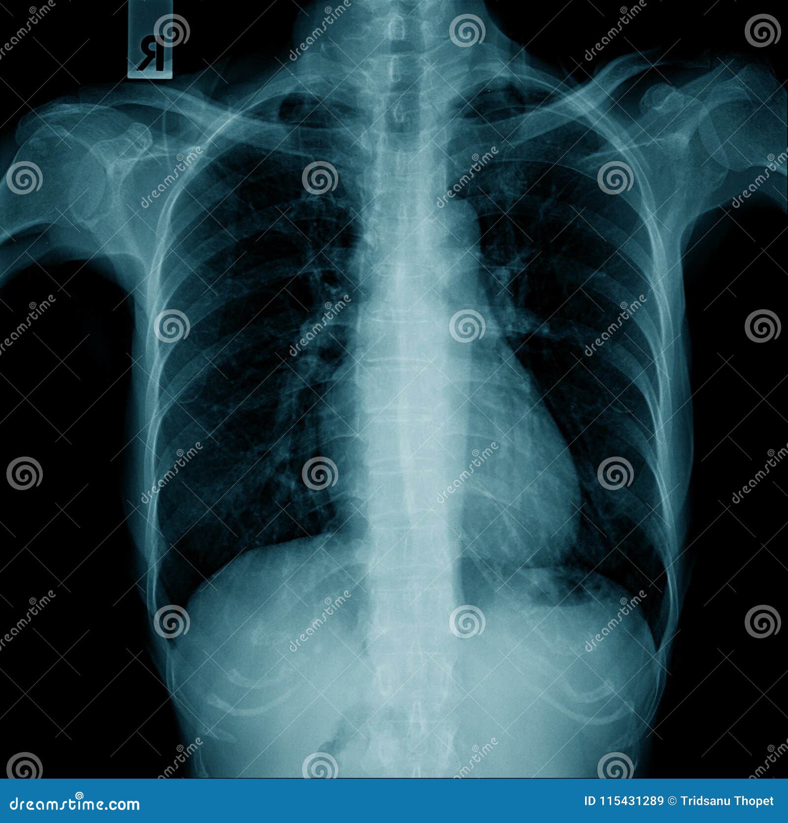 Chest x-ray good quality stock illustration. Illustration of anatomy ...