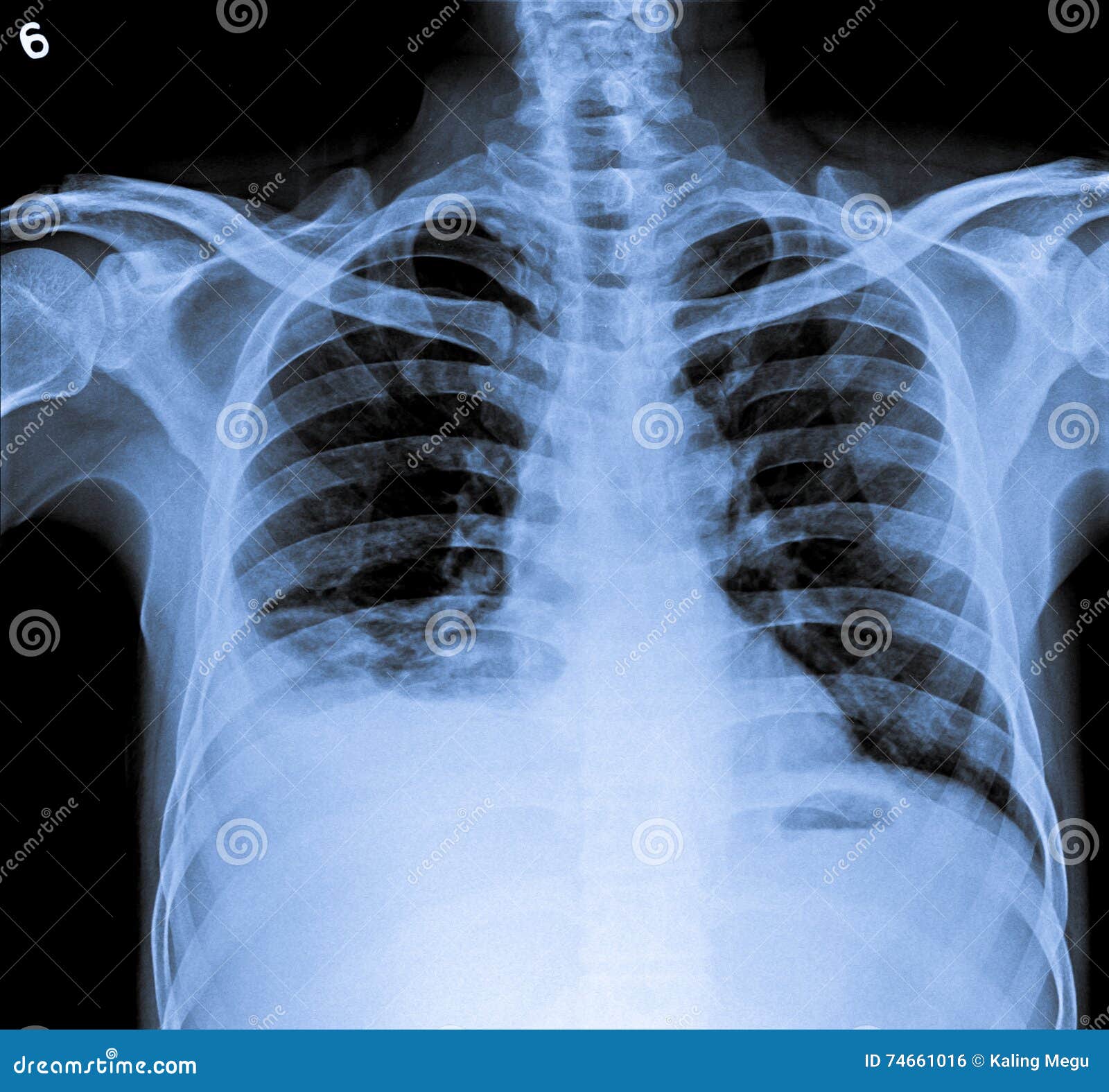Chest X Ray of Human Body with Right Plural Effusion. Stock Photo ...