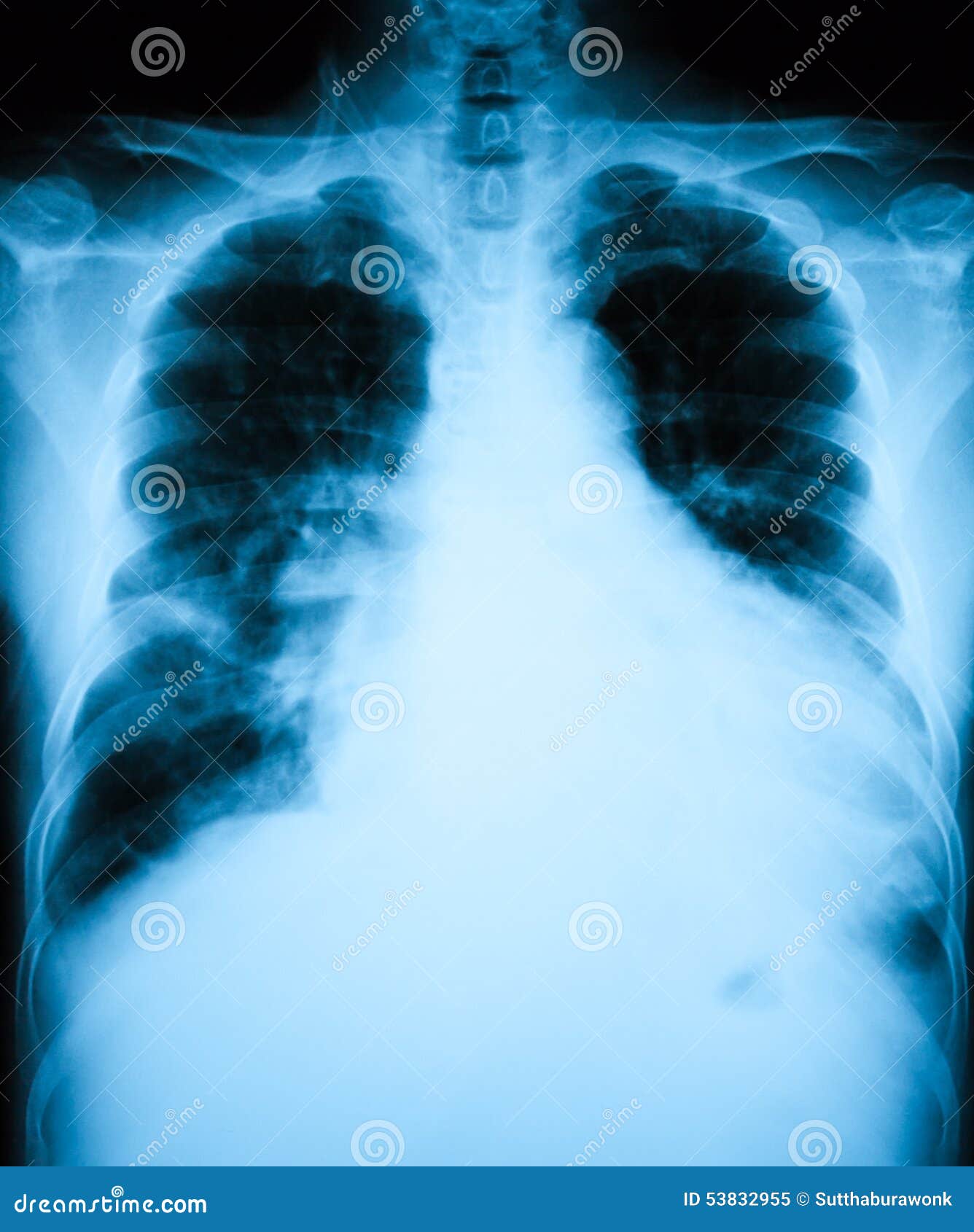 Chest X-ray Image, AP Upright View. Stock Image - Image of spine, chest ...