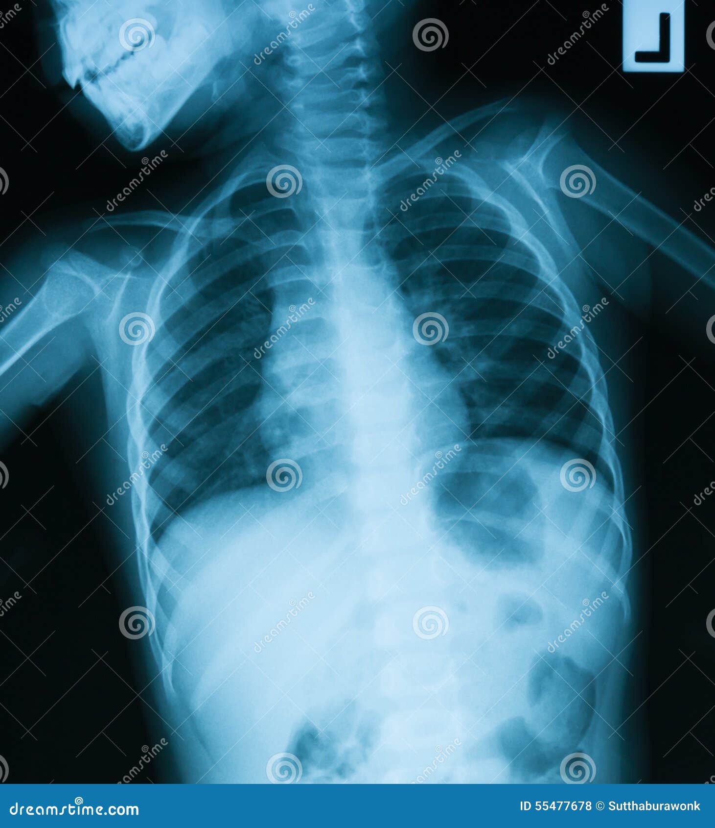 Chest X-ray Image, AP View. Stock Photo - Image of lung, exam: 55477678