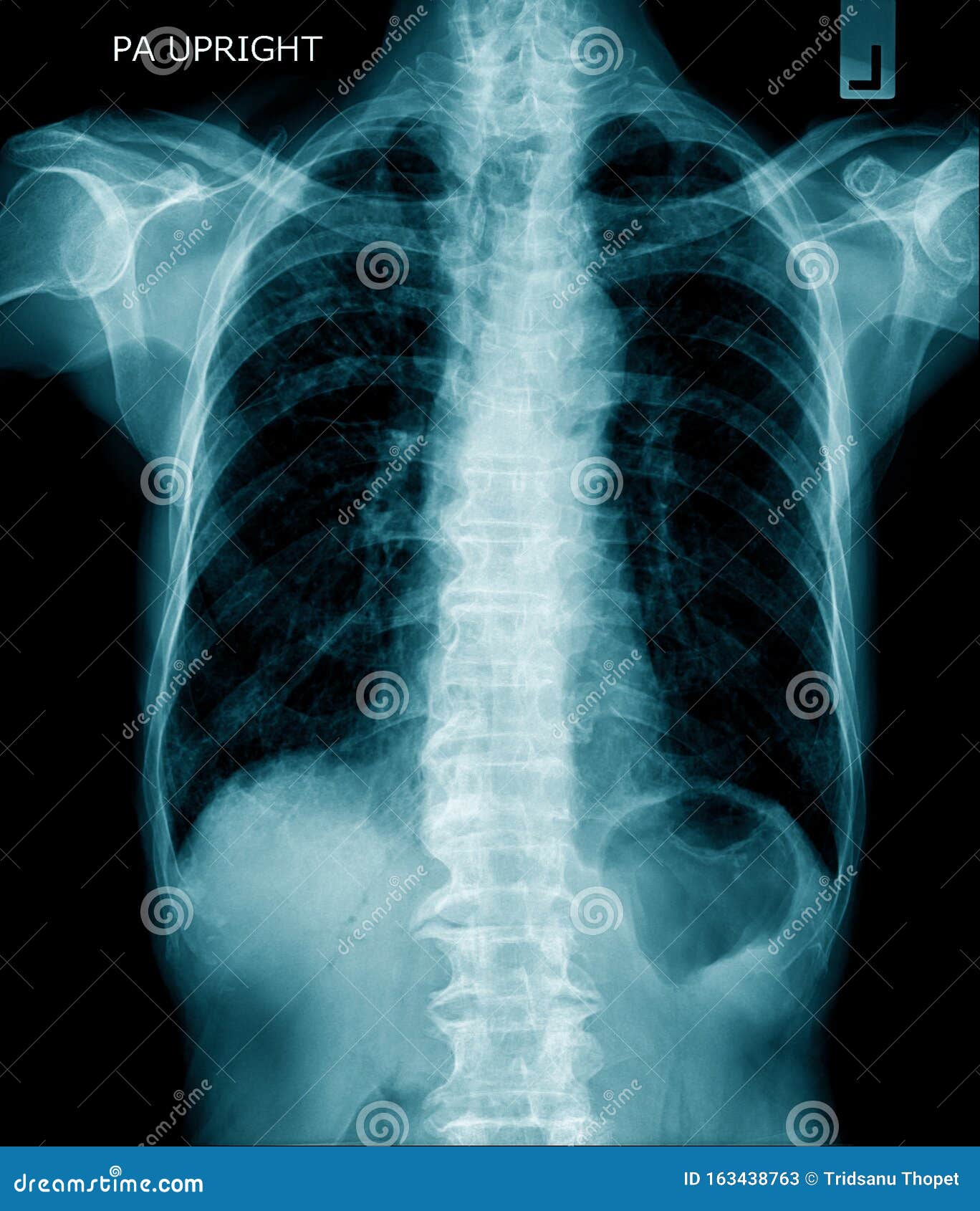 Chest X-ray Image in Blue Tone Stock Image - Image of human, medicine ...