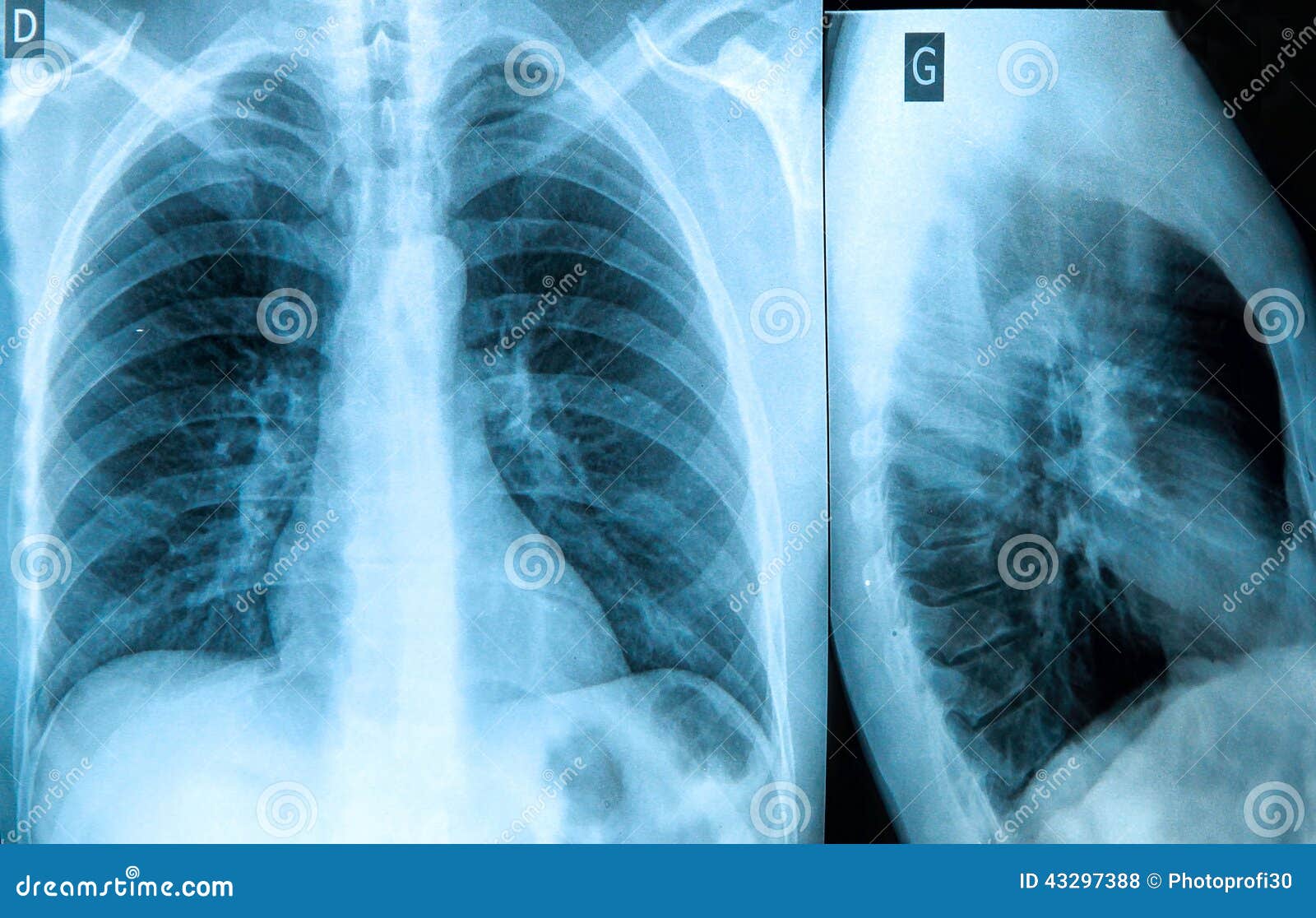 Chest X-ray Image stock photo. Image of hypertension - 43297388