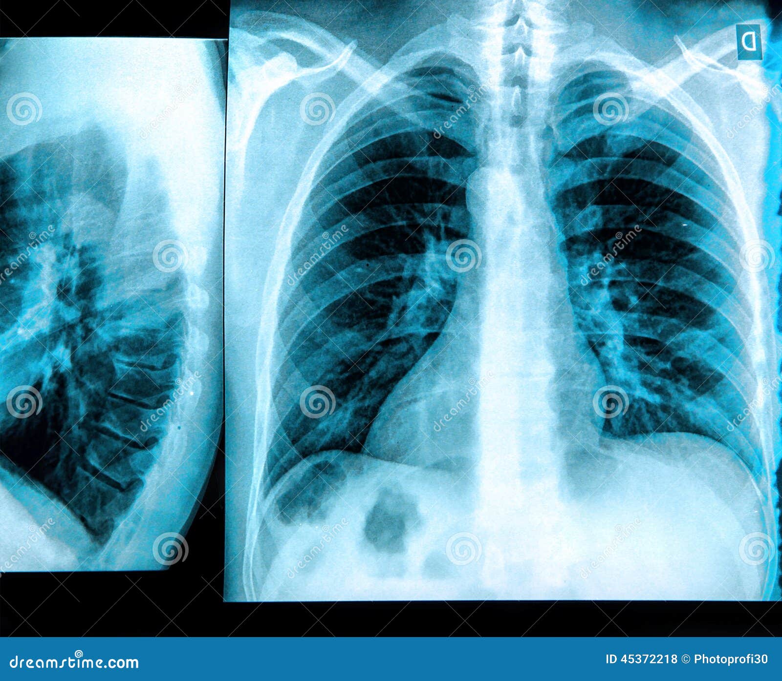 Chest X-ray Image stock photo. Image of illness, lung - 45372218