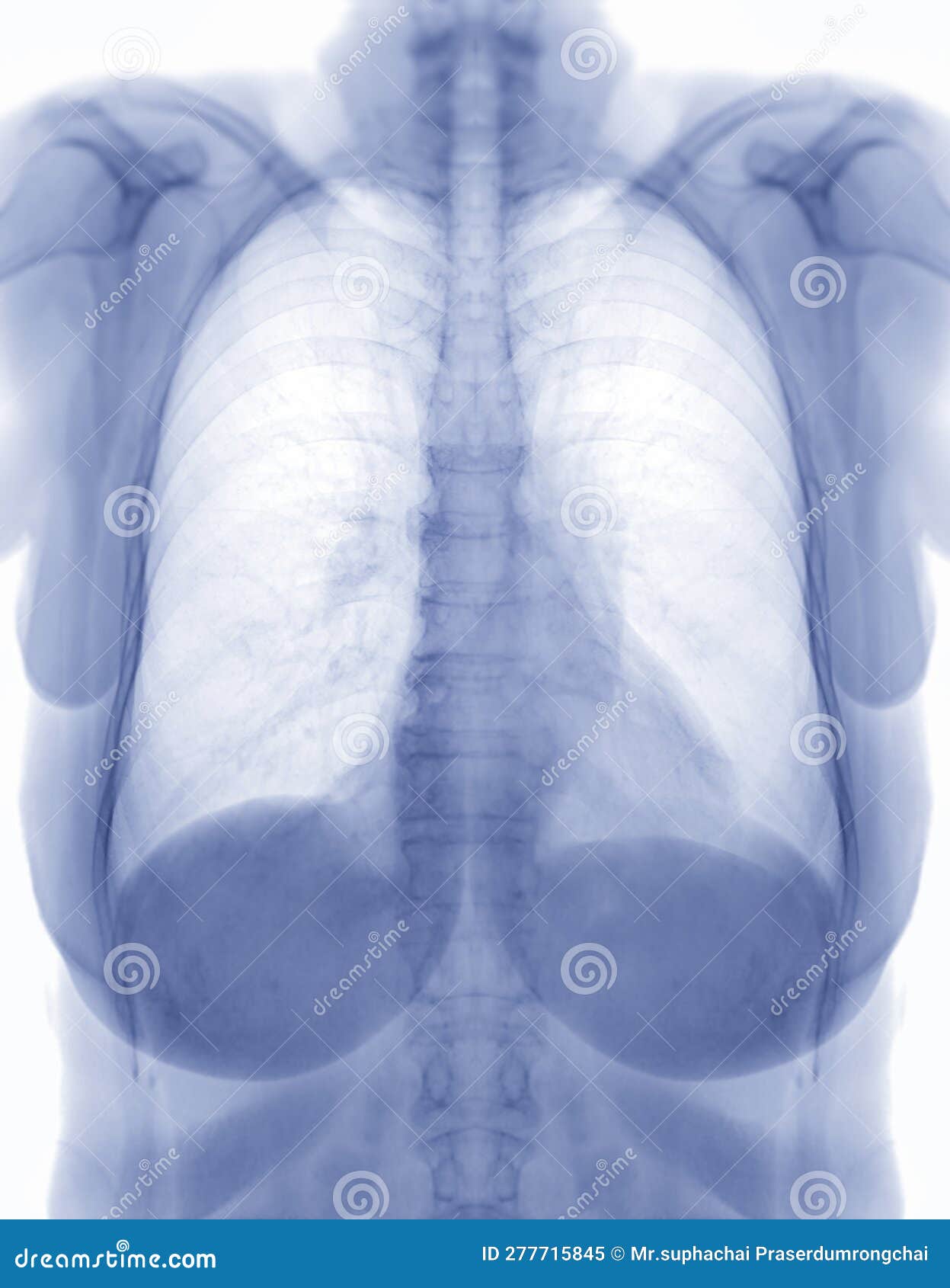 Chest X-ray Image Negative Filter Stock Image - Image of emphysema ...