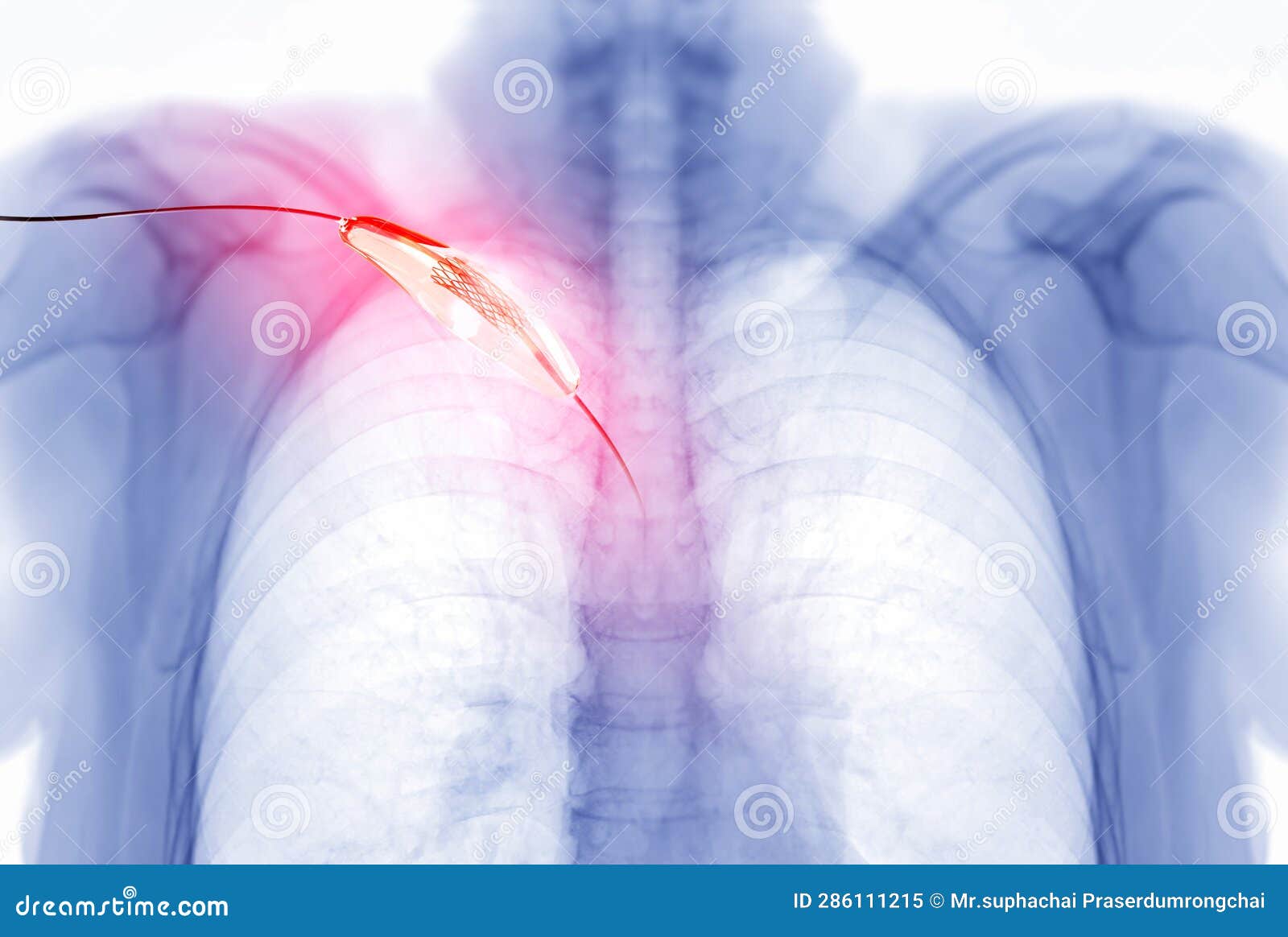 Chest X-ray Image Negative Filter Stock Image - Image of lungs, health ...