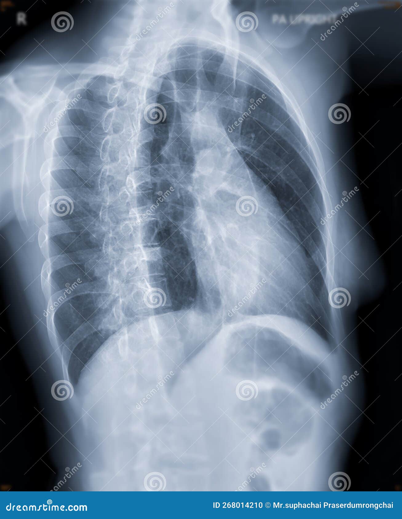 Chest X-ray Image Oblique View for Screening Diagnosis TB,tuberculosis ...
