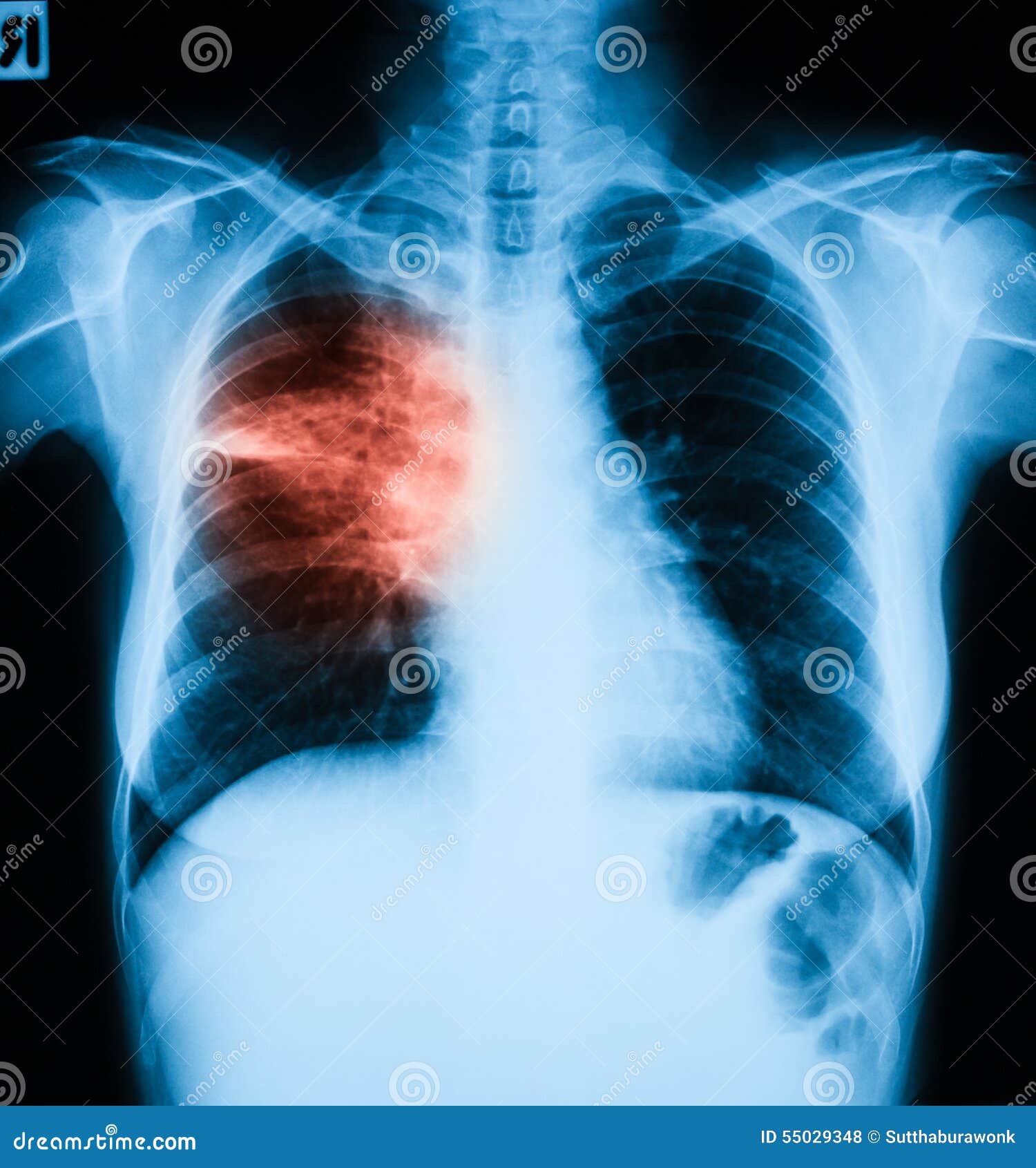 Chest X-ray Image, PA Upright Position. Stock Photo - Image of position ...