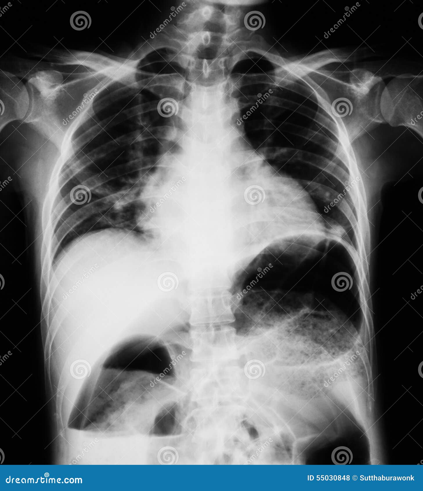 Chest X-ray Image, PA Upright View. Stock Photo - Image of body ...