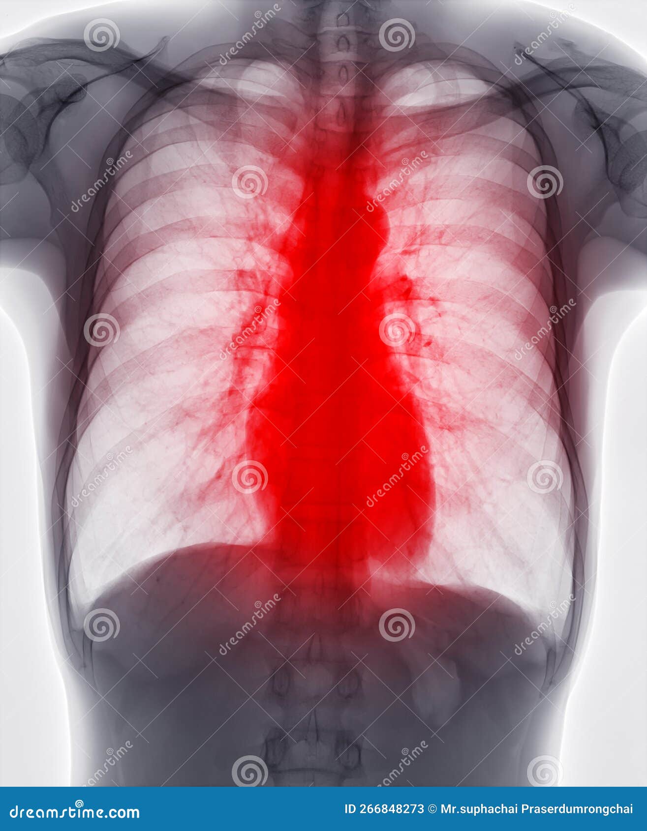 Chest X-ray Image for Screening Diagnosis TB,tuberculosis and Covid-19 ...