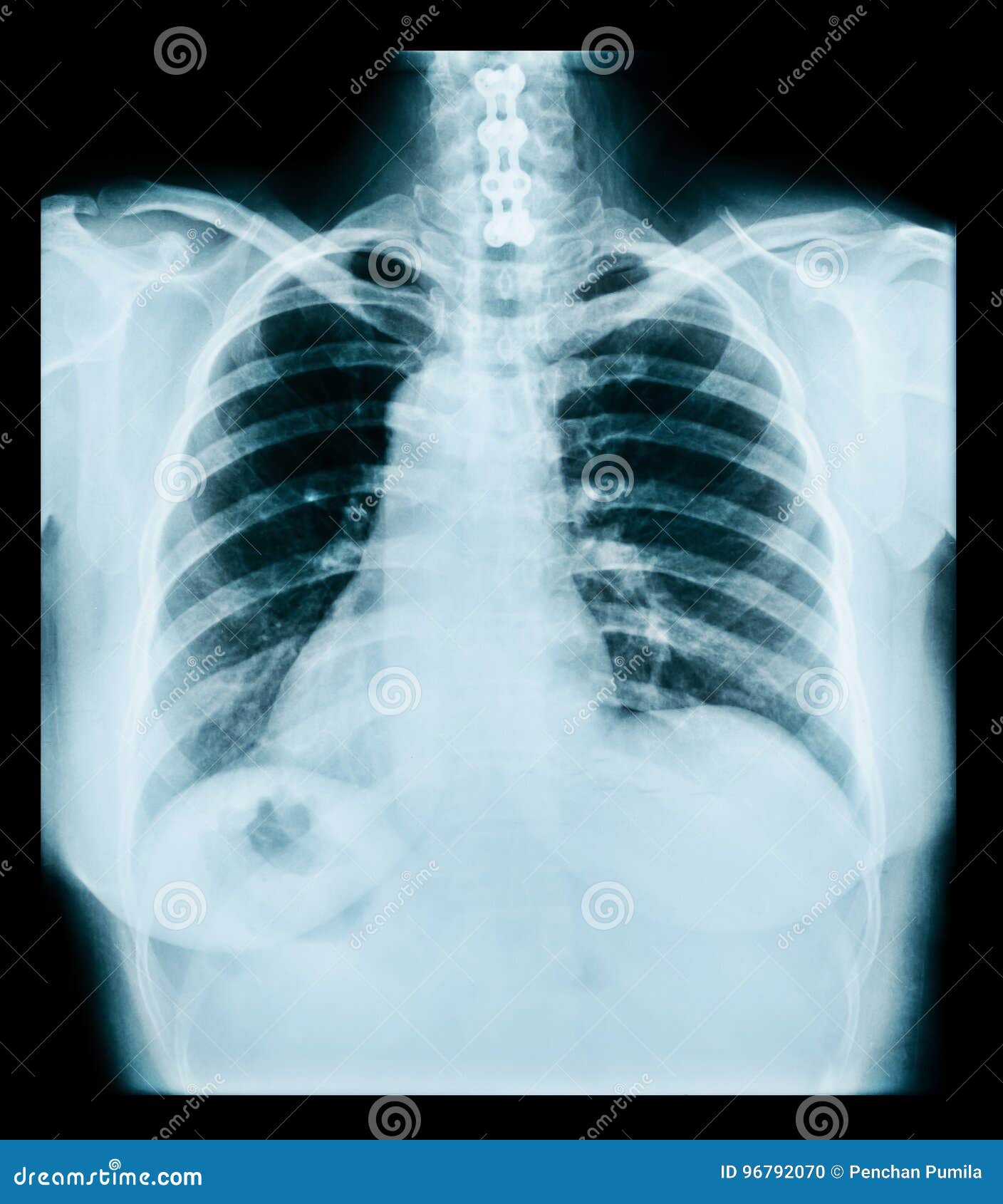 Chest x ray. stock photo. Image of clinical, human, lung - 96792070