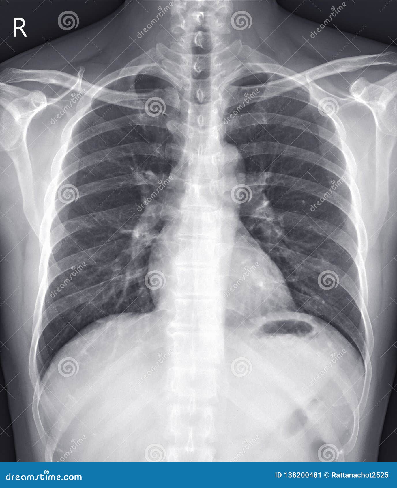 Normal Chest Ray Male Stock Illustrations – 33 Normal Chest Ray Male ...